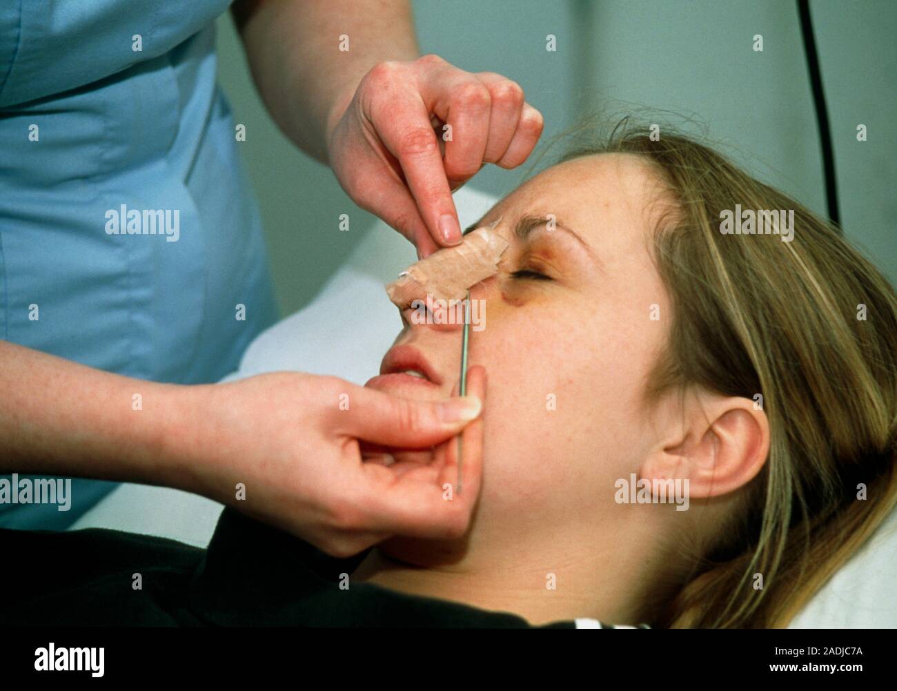 Plaster removal after rhinoplasty. Nurse removing a plaster from the ...