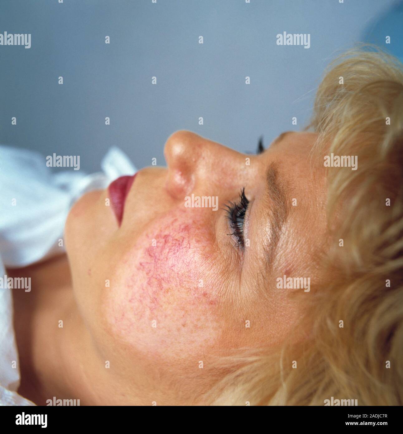 Image 1 of 3. Cosmetic laser surgery. Broken skin vessels on a patient ...