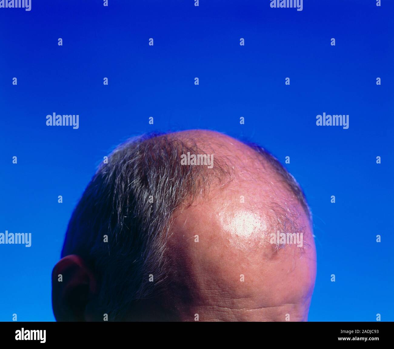 Hair transplant patient. Image 1 of 9. Crown of a man's head prior to a ...