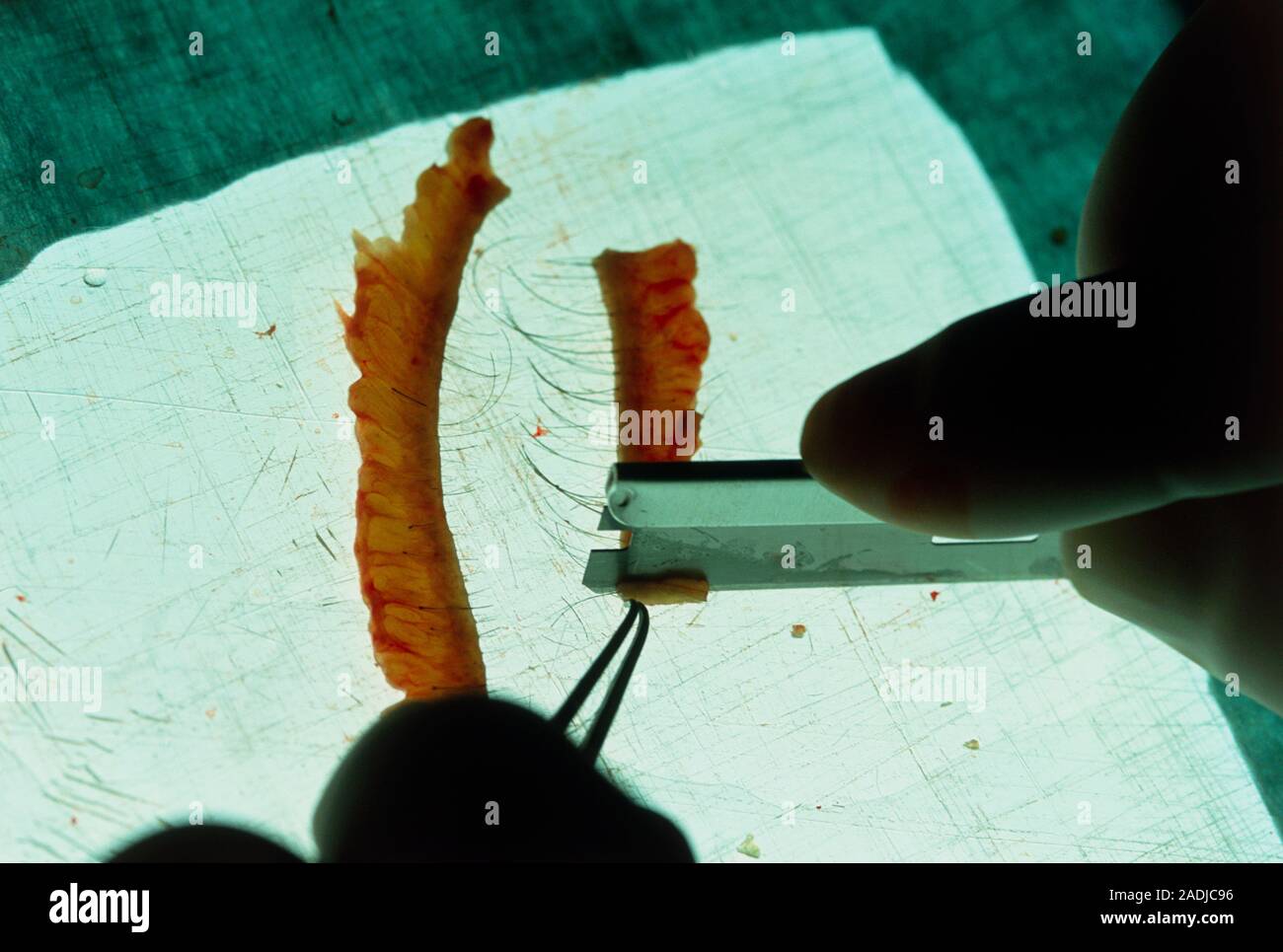 Hair transplant surgery. Image 3 of 9. Surgeon preparing plugs of hair ...
