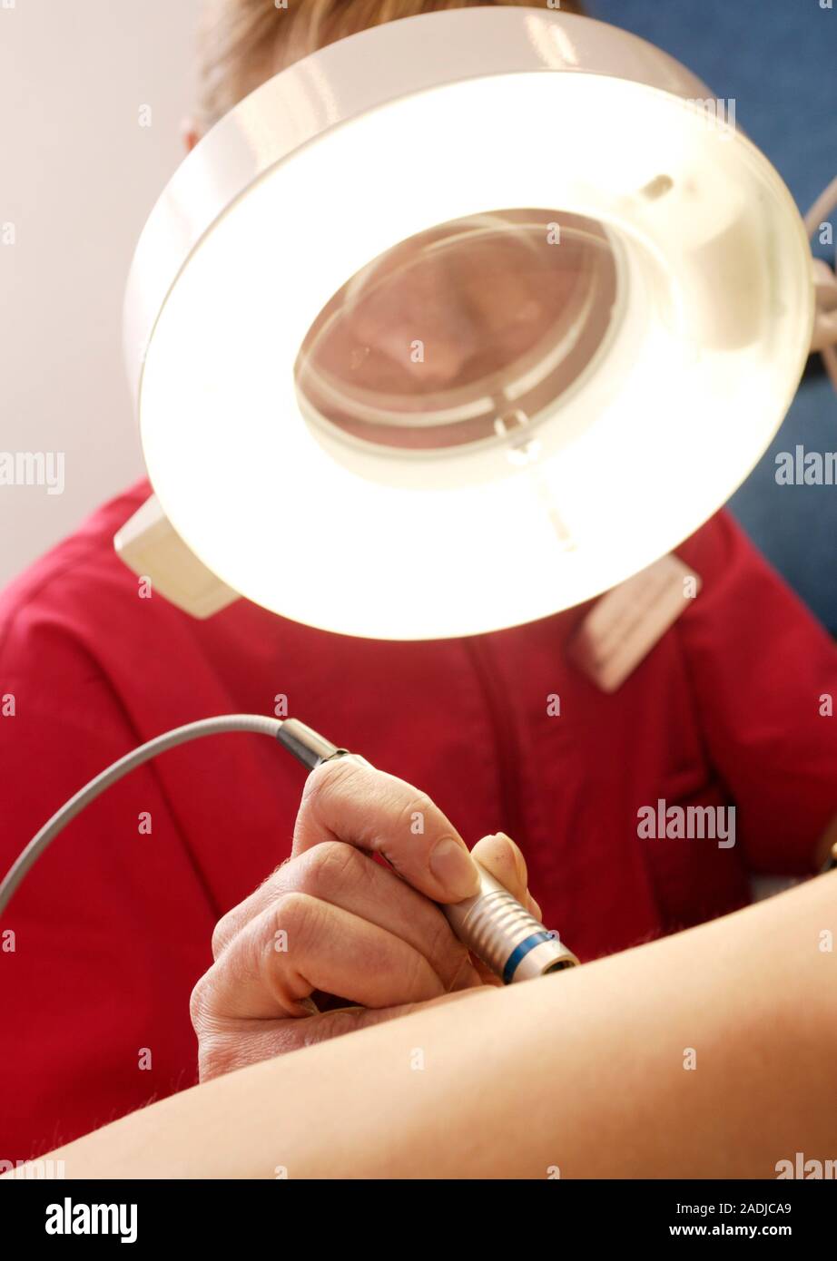Laser thread vein treatment. Laser operator using a laser to remove ...