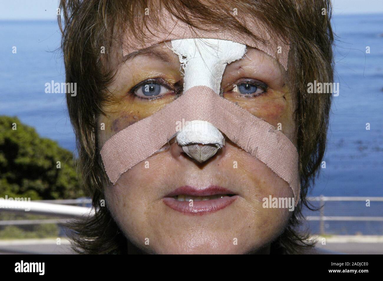 Nose and eye surgery. Image 5 of 5. 54-year-old woman wearing a nose ...