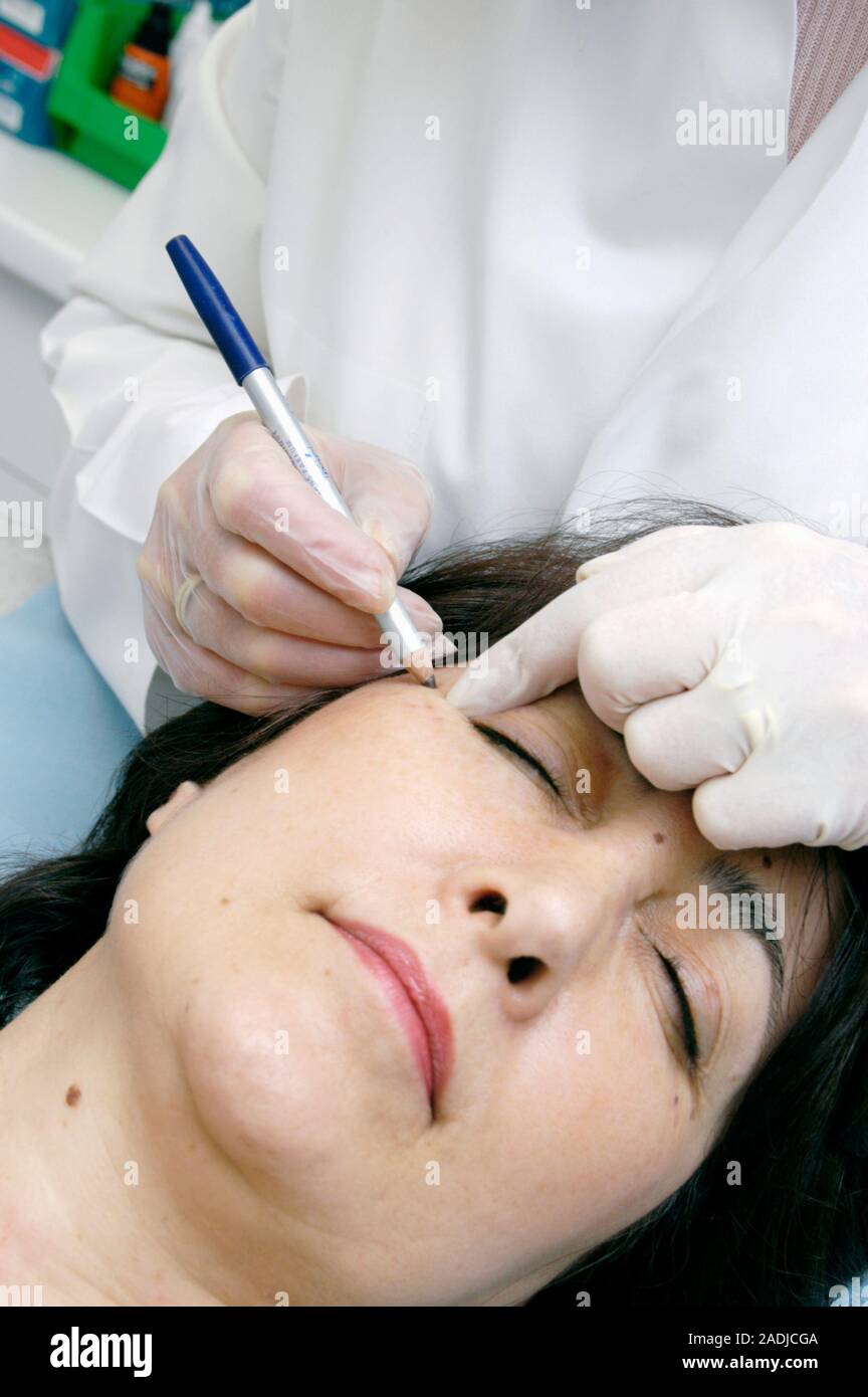 MODEL RELEASED. Botox treatment. Dermatologist marking a client's face ...