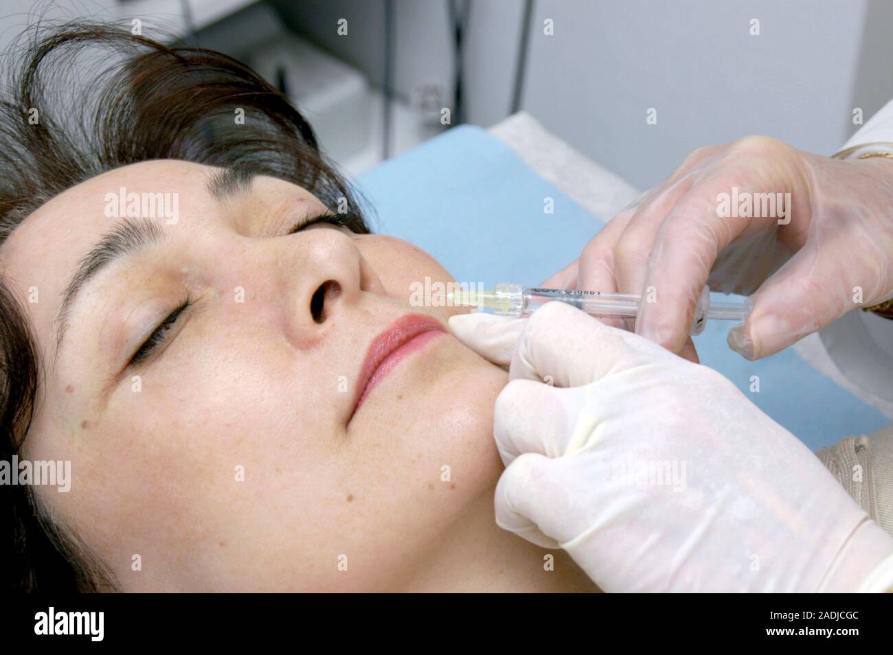 MODEL RELEASED. Botox treatment. Dermatologist injecting a client's ...