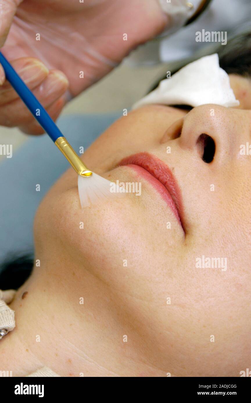 Chemical peel. Dermatologist applying a chemical agent to a woman's ...