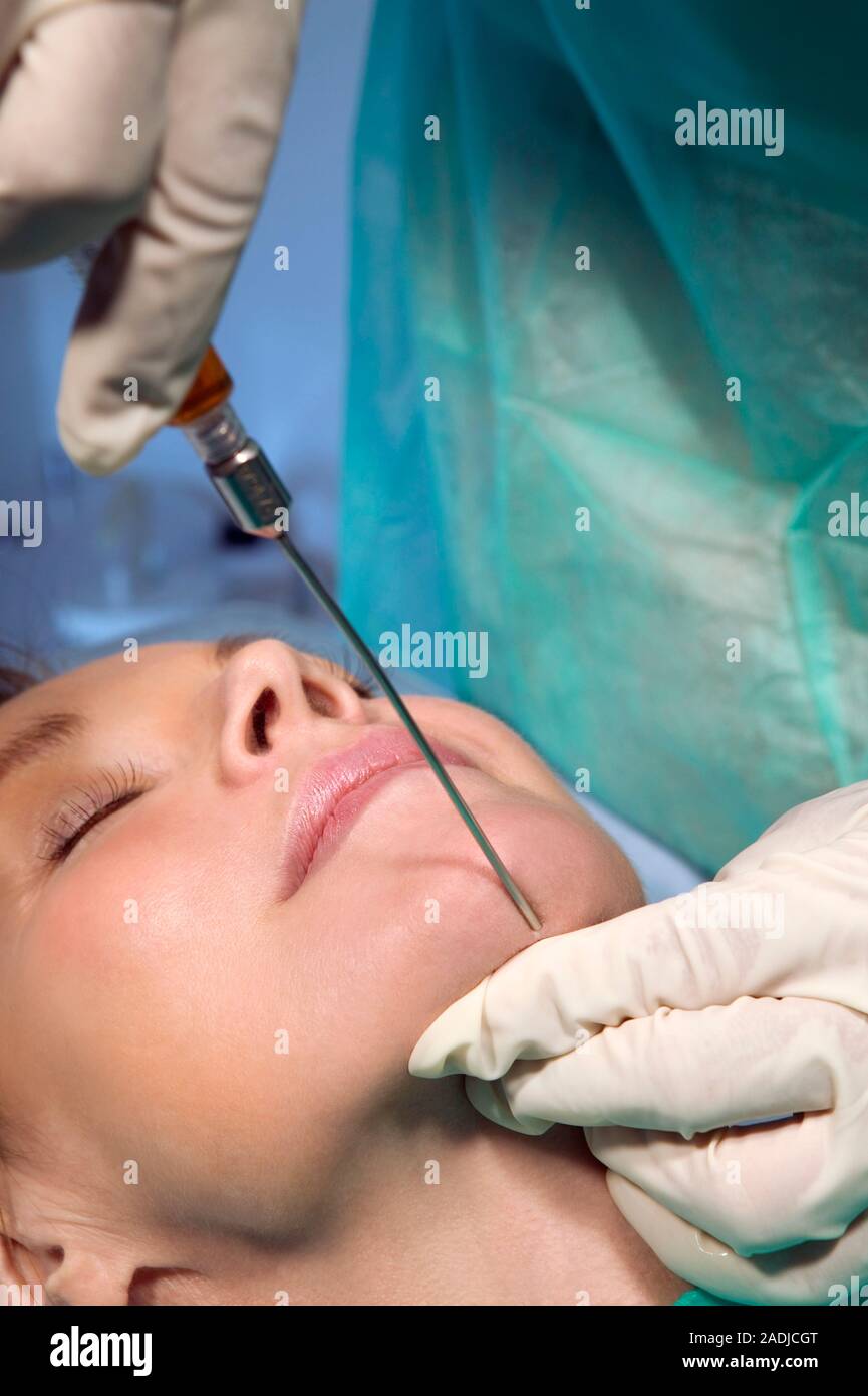 Liposuction surgery. Surgeon using a large needle and syringe to ... Liposuction surgery. Surgeon using a large needle and syringe to ...