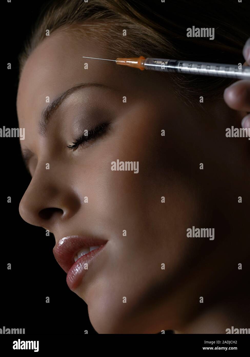 MODEL RELEASED. Botox treatment. Botox is a neurotoxin used for ...