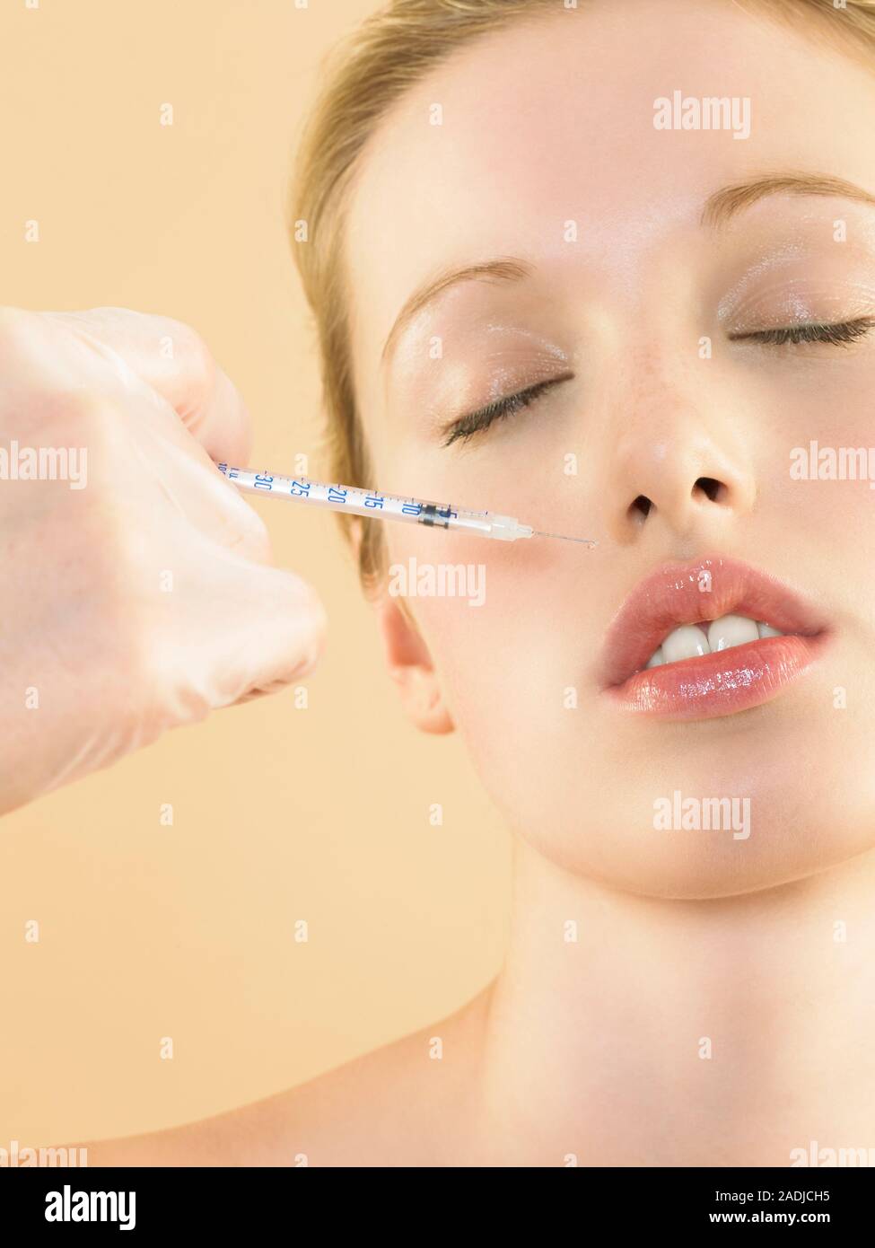 MODEL RELEASED. Botox treatment. Botox is a neurotoxin used for ...