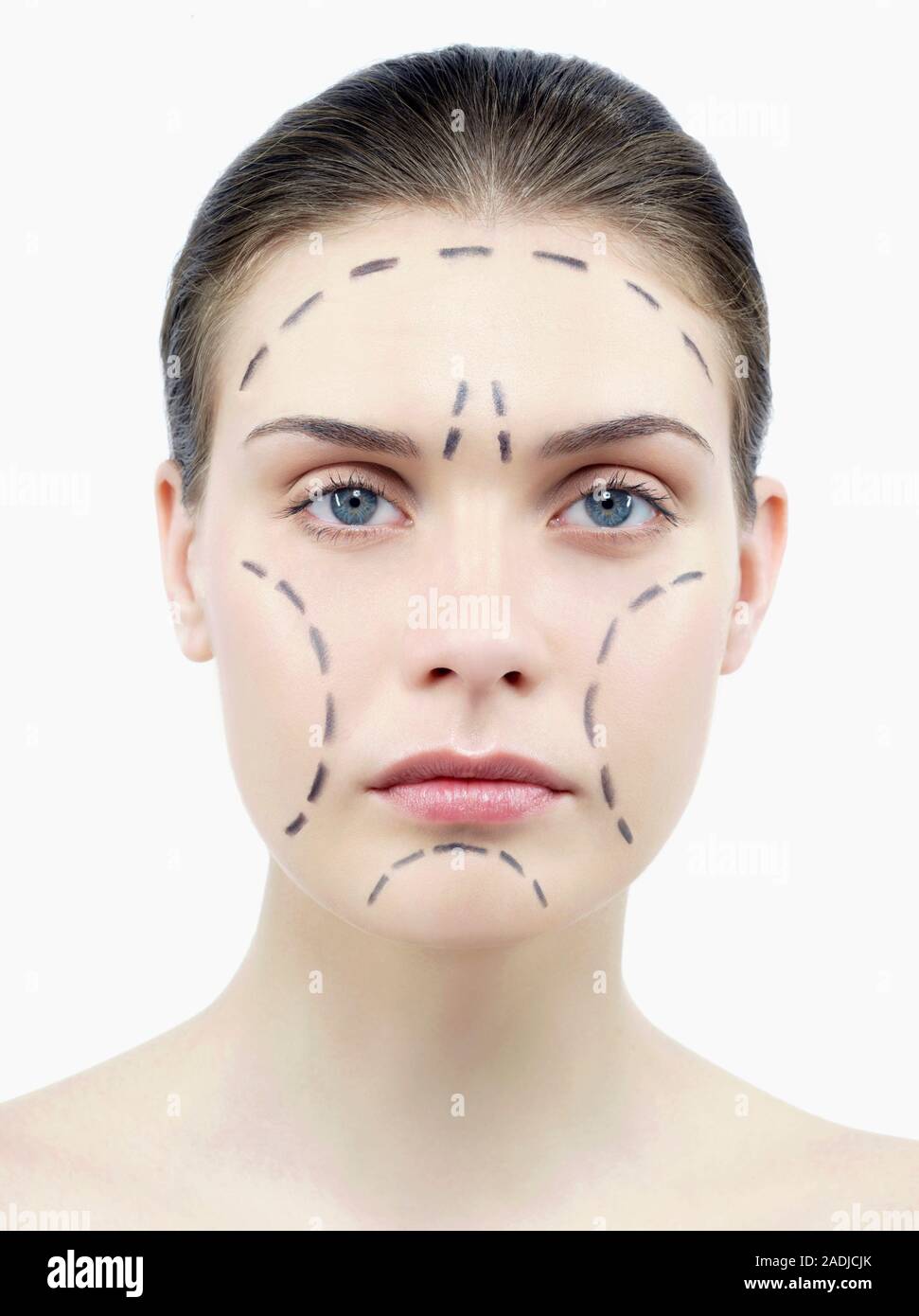 Facelift surgery markings. Guide lines for surgical incisions on a ...