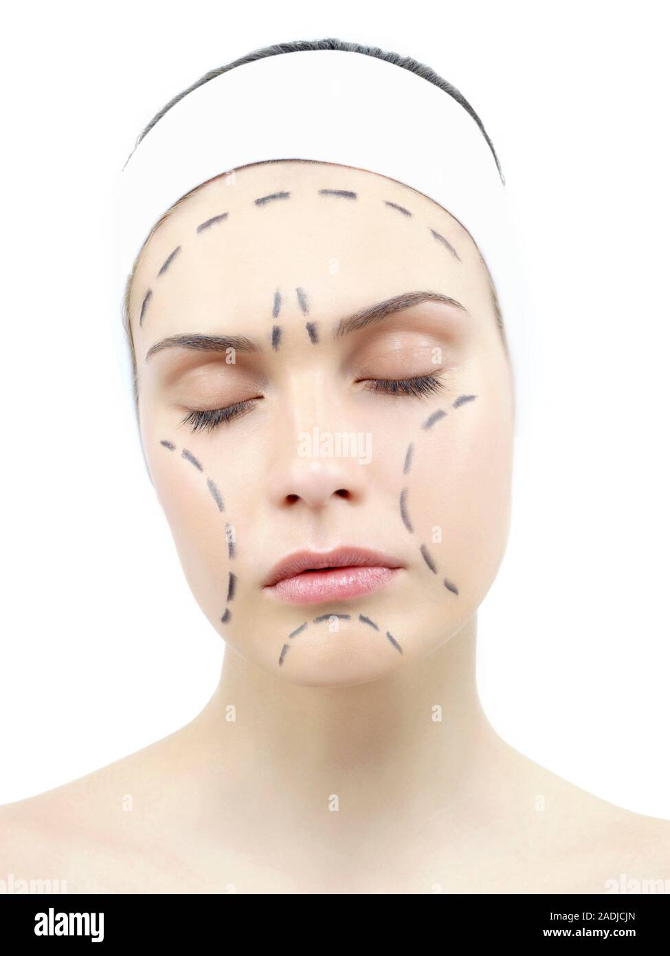 MODEL RELEASED. Facelift surgery markings. Guide lines for surgical ...