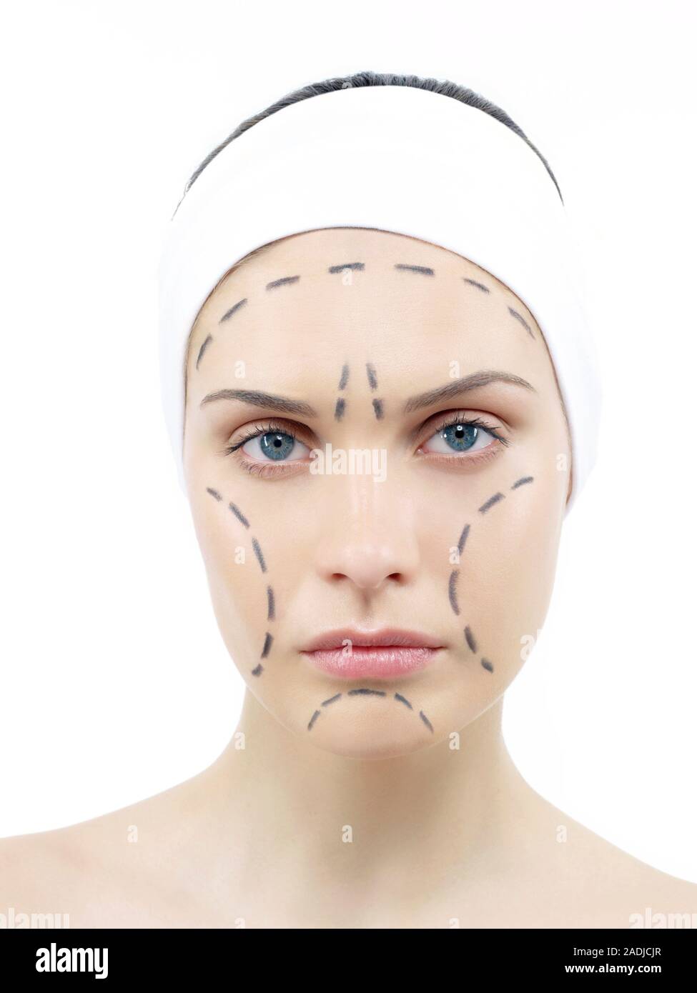 Facelift surgery markings. Guide lines for surgical incisions on a ...