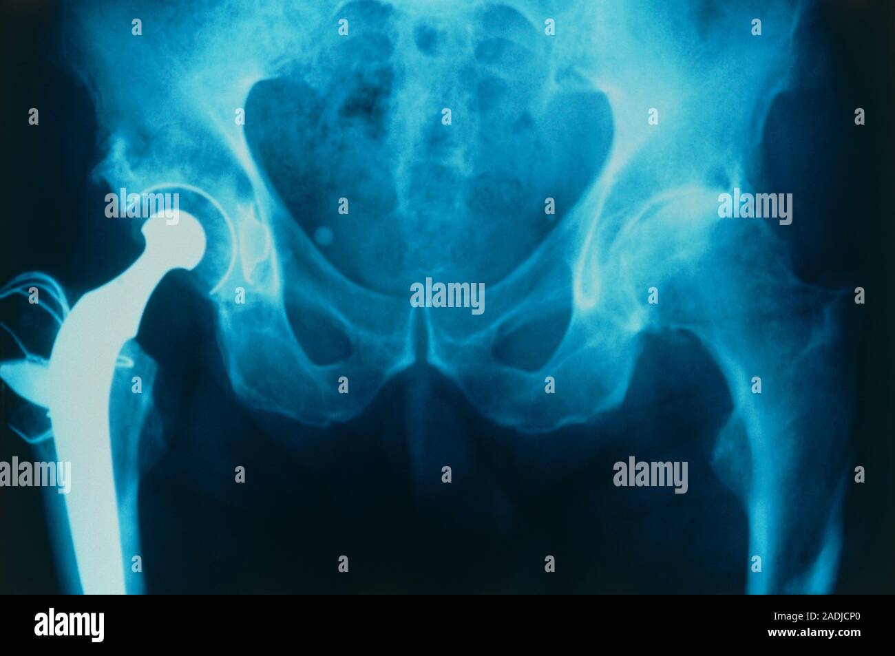 Artificial hip. X-ray of an artificial (prosthetic) hip joint in place ...