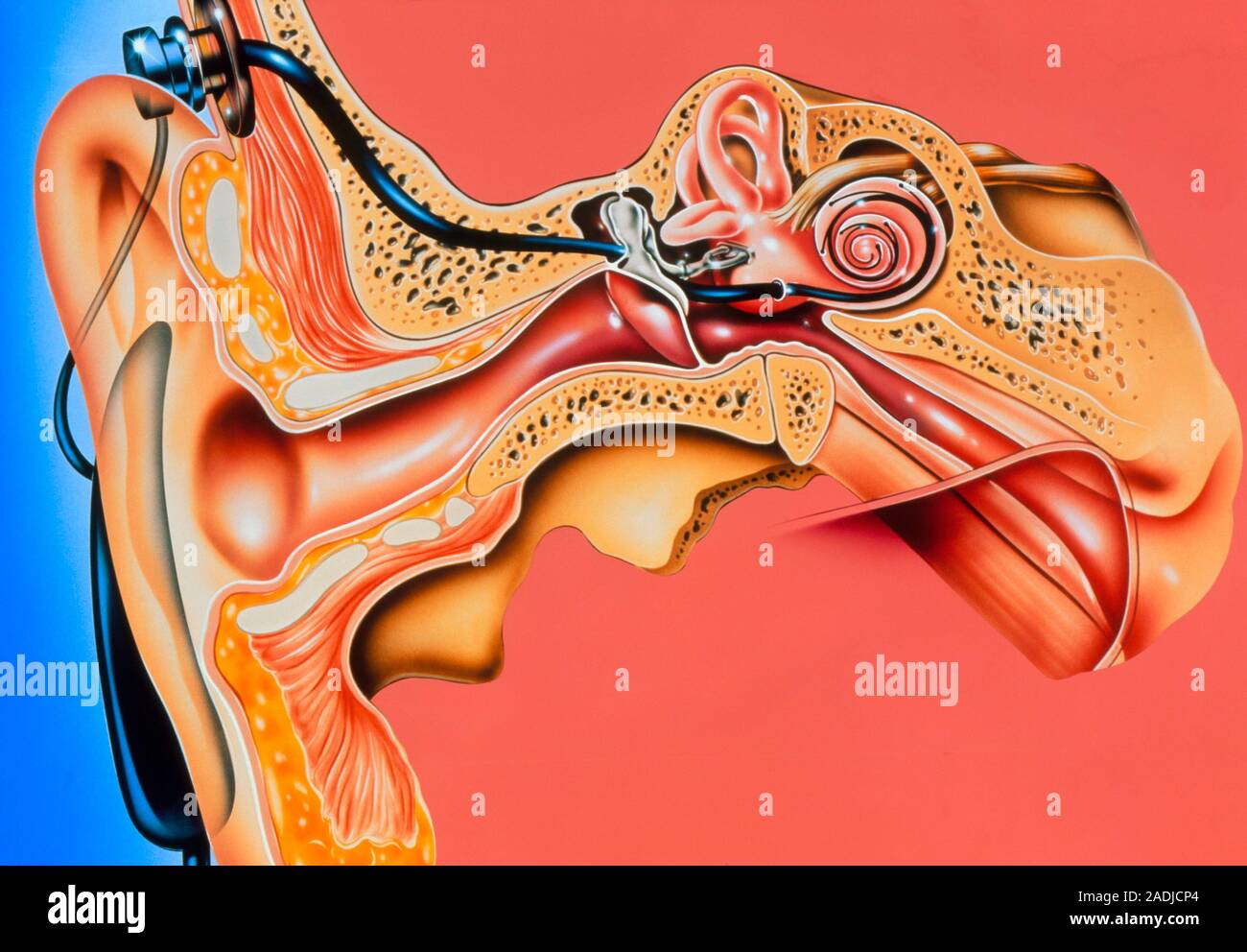 Cochlear implant. Illustration of a cochlear implant in a human ear ...