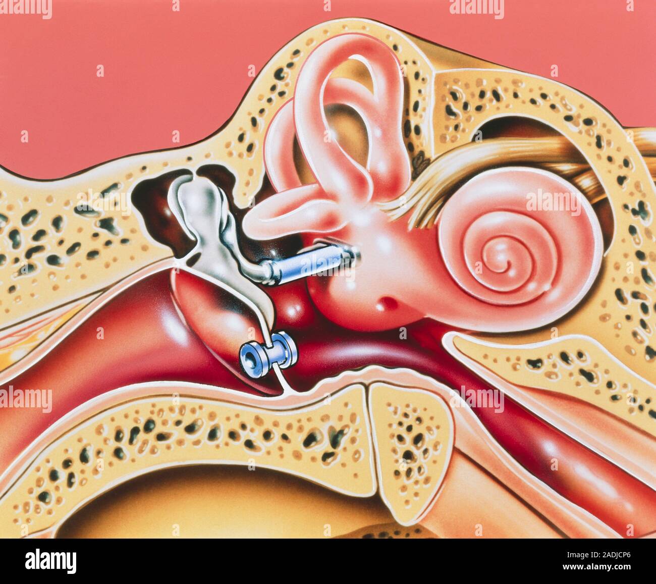 Prosthetic stapes. Illustration of a prosthetic (artificial) stapes ...