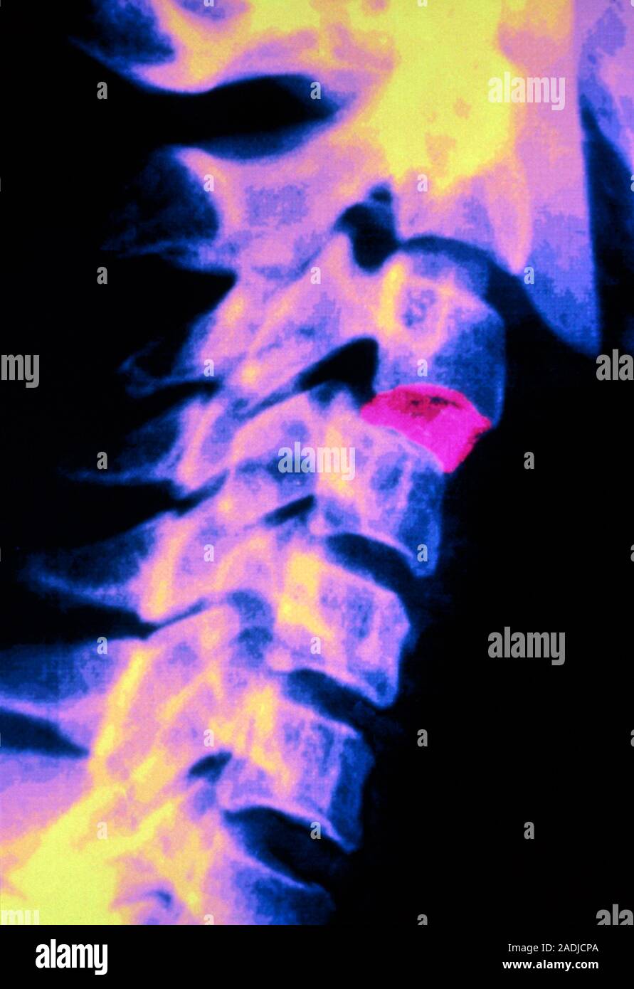 Intervertebral disc implant. Coloured X-ray image of the cervical ...