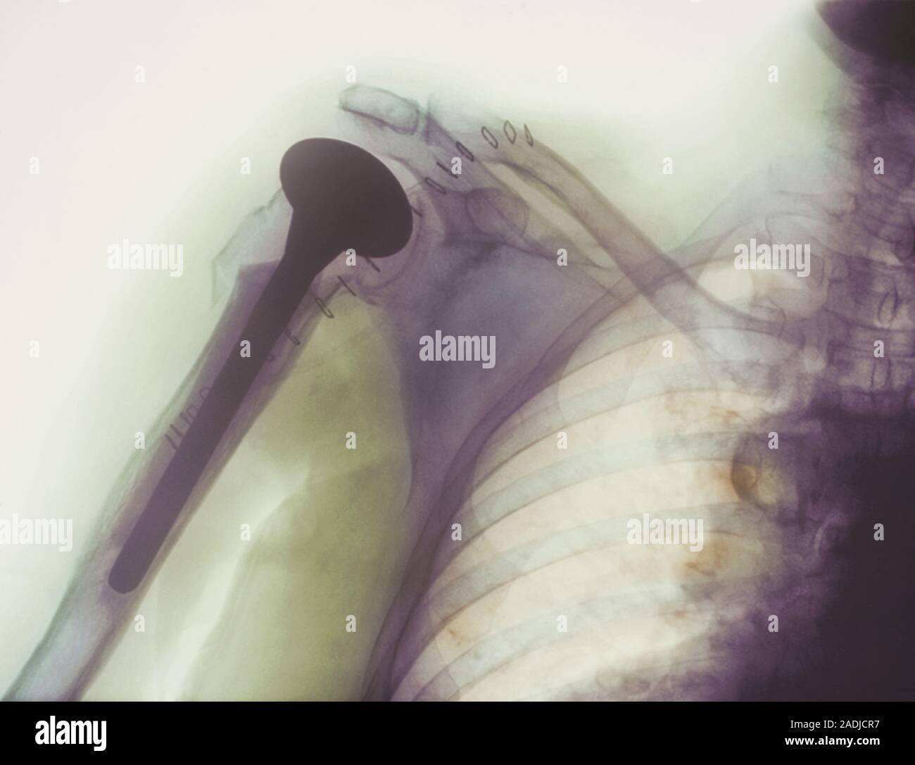 Shoulder prosthesis. Coloured X-ray of a prosthetic (artificial ...