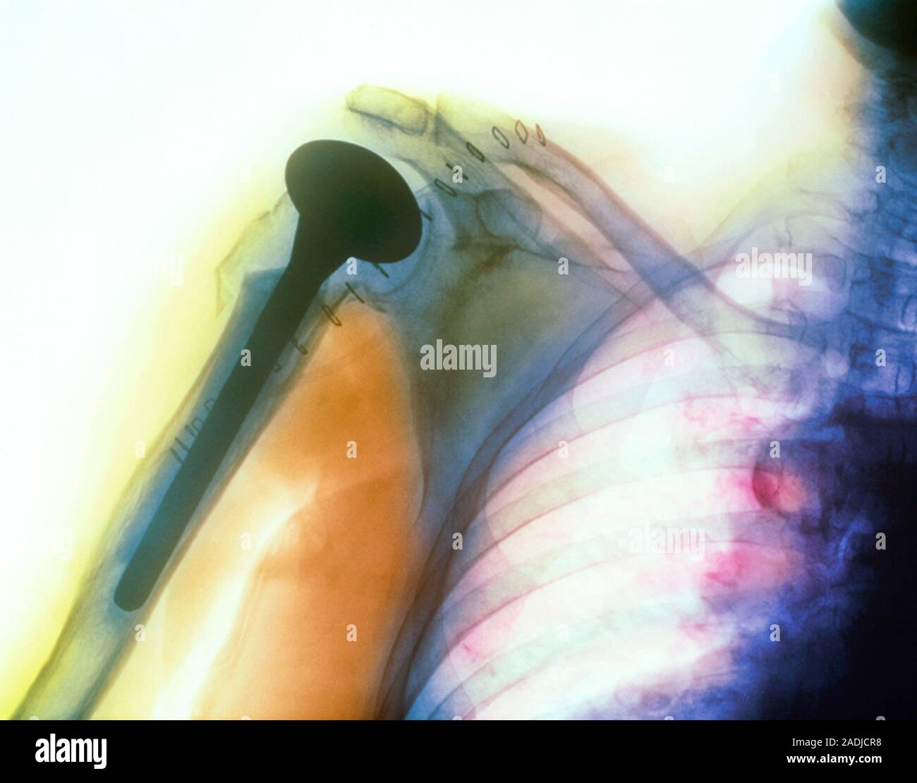Shoulder prosthesis. Coloured X-ray of a prosthetic (artificial ...