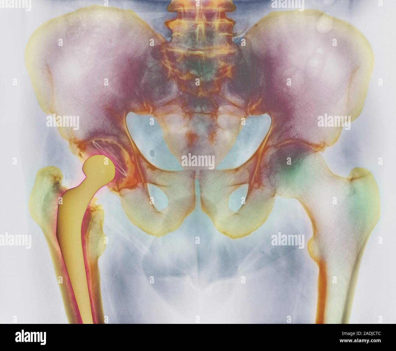 Hip replacement. Coloured X-ray of a man's pelvis (front view), showing ...