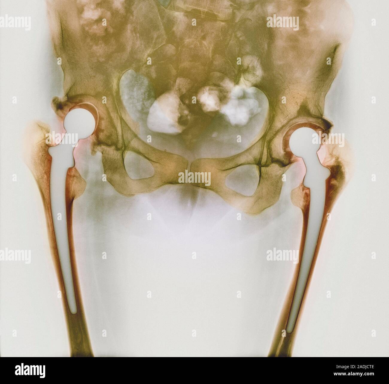 Double hip replacement. Coloured X-ray of a female patient's hips with ...
