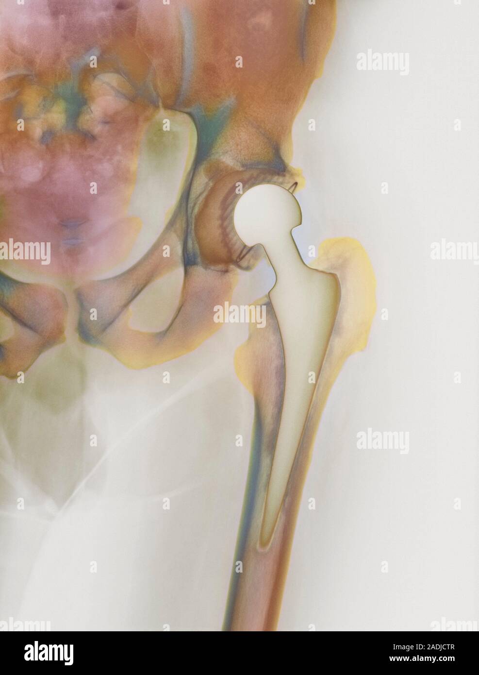 Loosened hip replacement. Coloured X-ray of a man's hip showing a ...