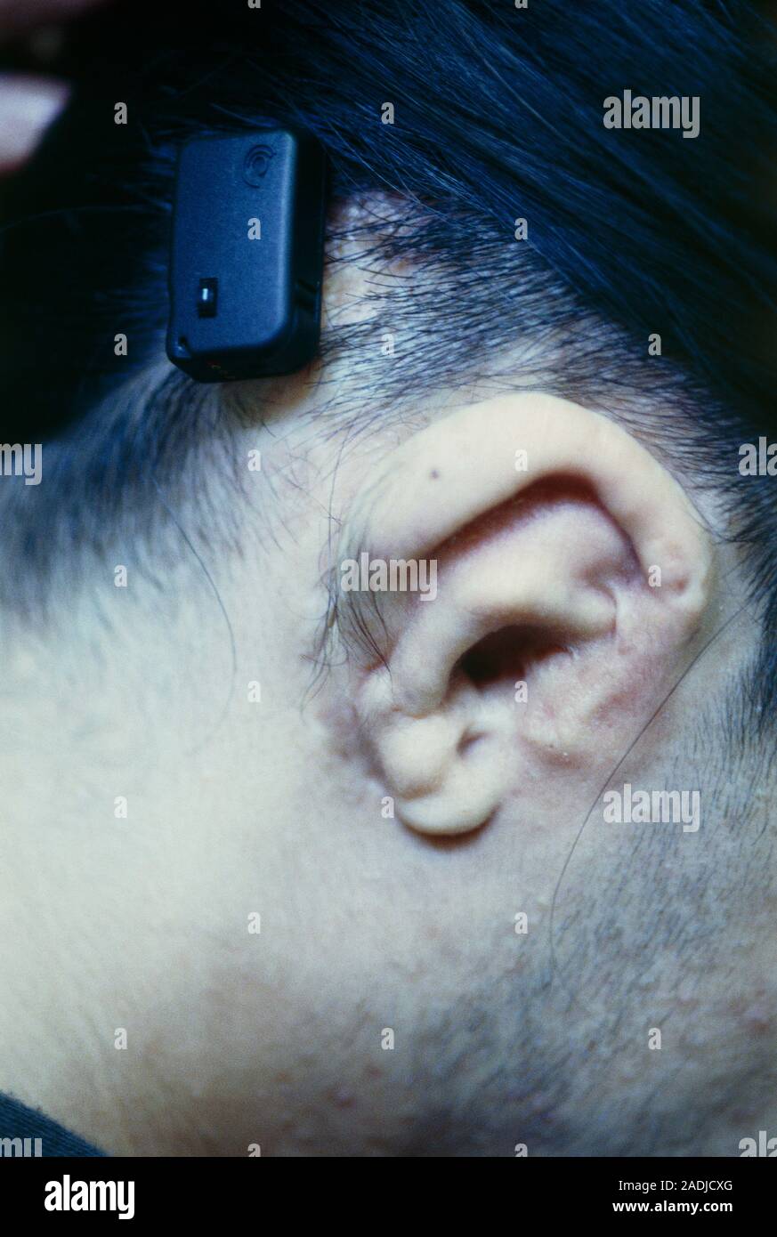 Hearing aid. Bone anchored hearing aid (BAHA) in place behind a person ...