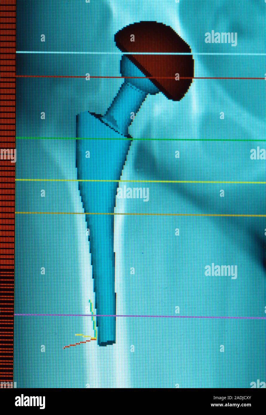 Planning hip replacement operation. Computer model of a hip prosthesis ...