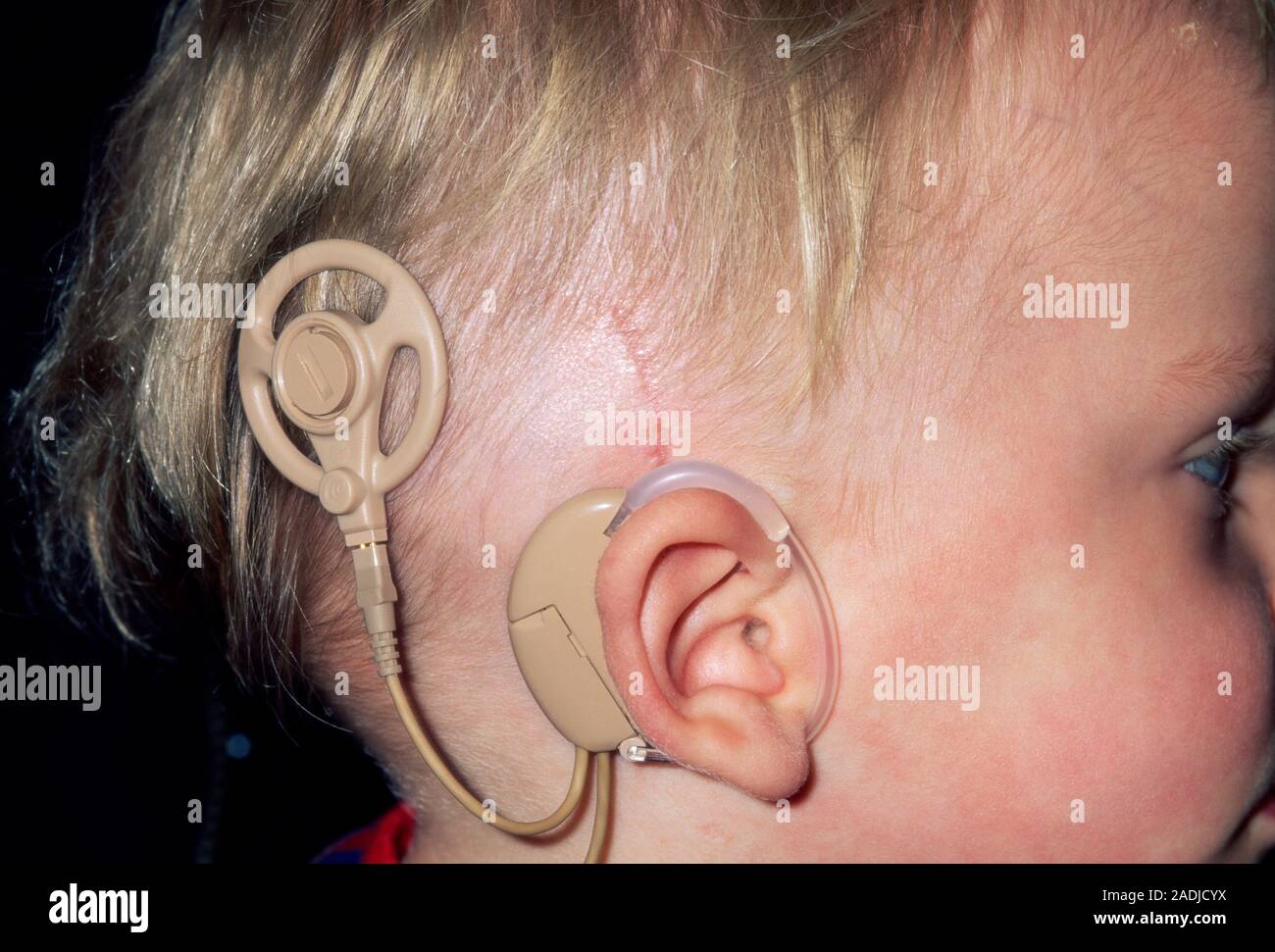 Cochlea implant. Two-year-old boy with a newly fitted cochlea implant ...