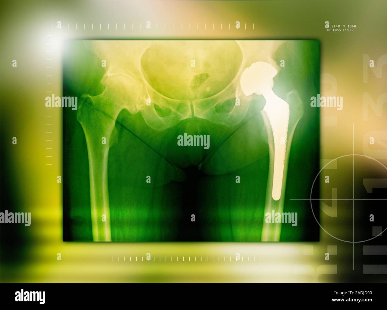 Hip replacement. Coloured X-ray of the pelvis of a female patient who ...