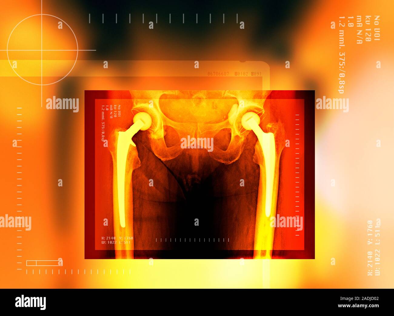 Double hip replacement, coloured X-ray. The metal prosthetic hip joints ...