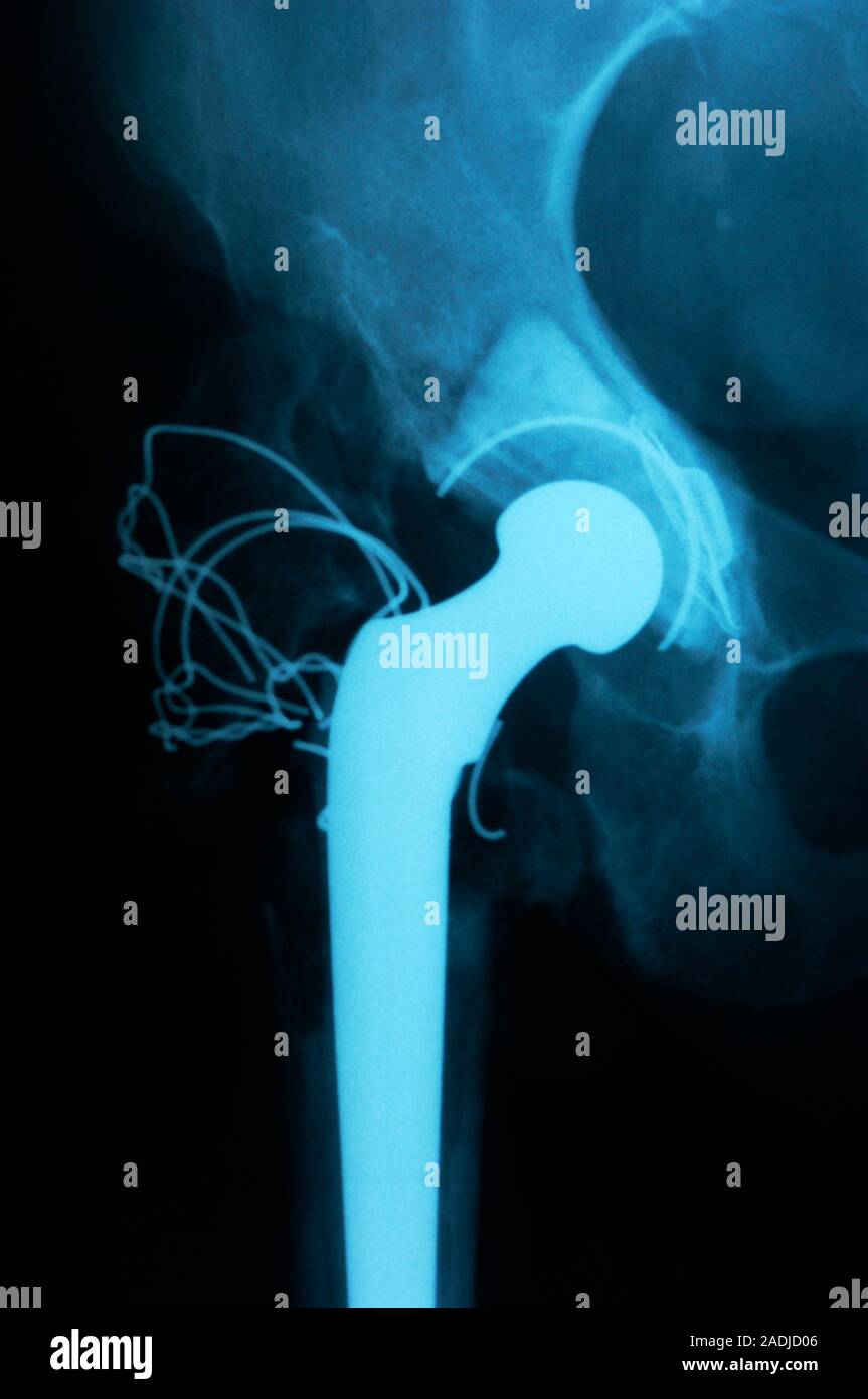 Total hip replacement, coloured X-ray. The replacement hip consists of ...