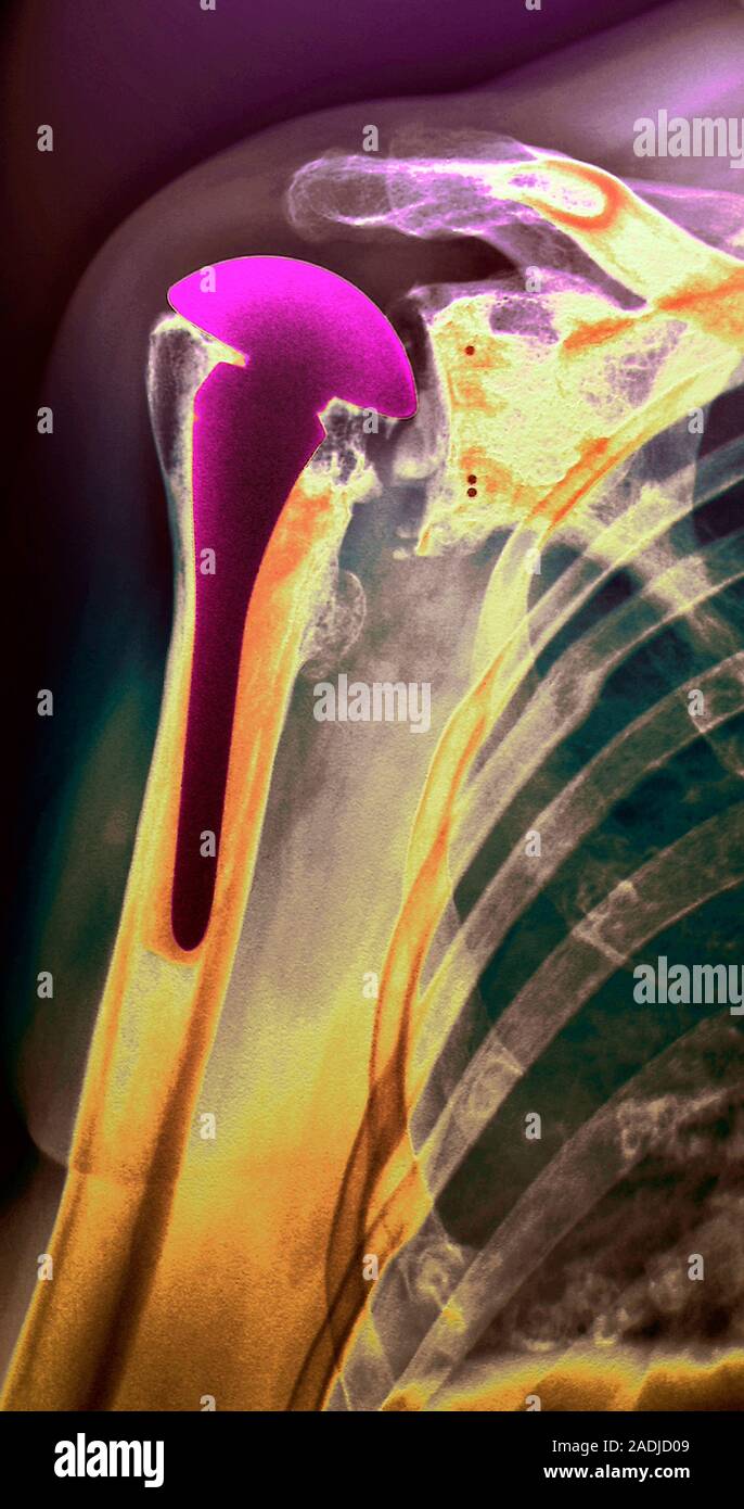 Artificial shoulder. Coloured X-ray of an artificial (prosthetic ...