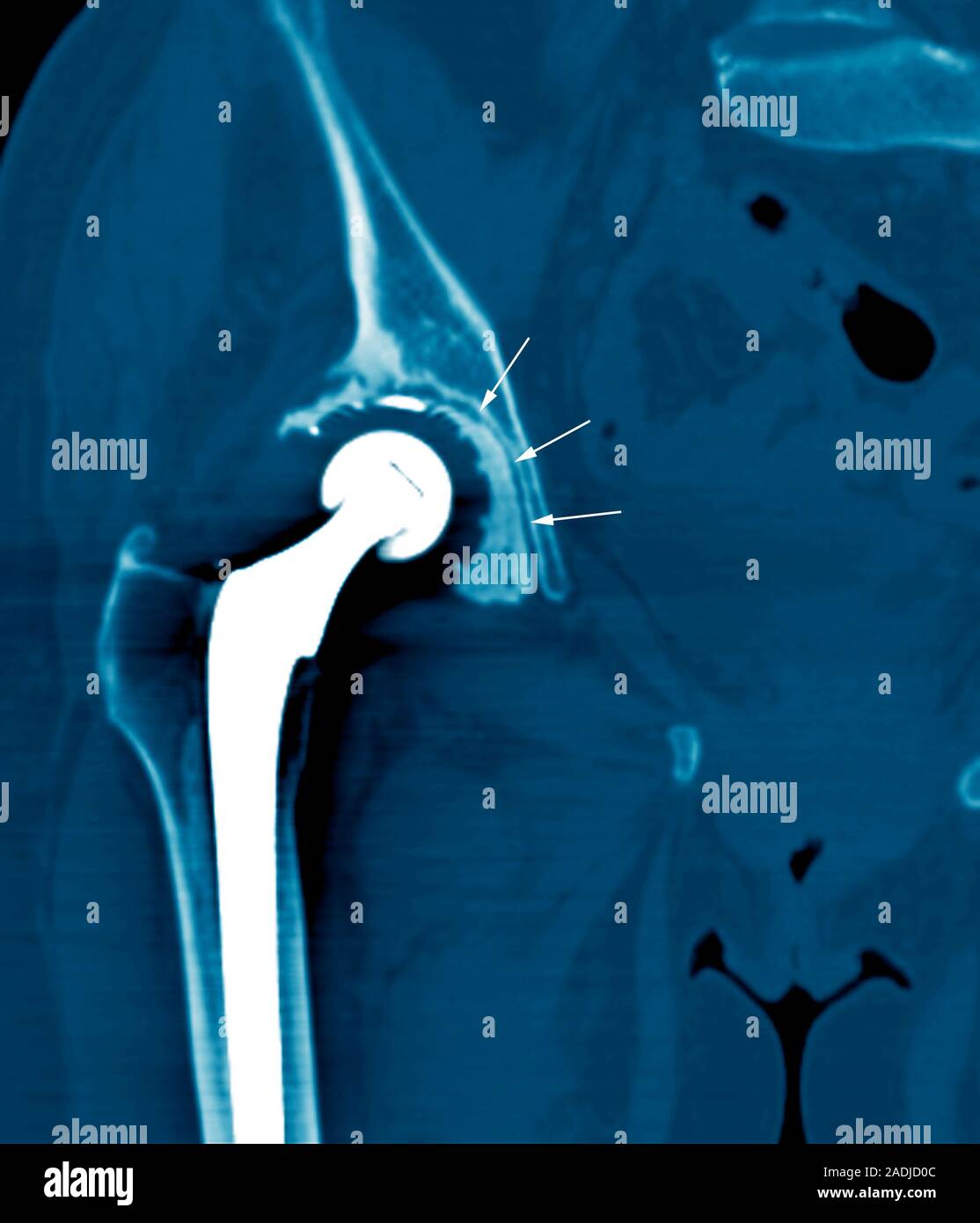 Loosened hip replacement. Coloured computed tomography (CT) scan of the ...