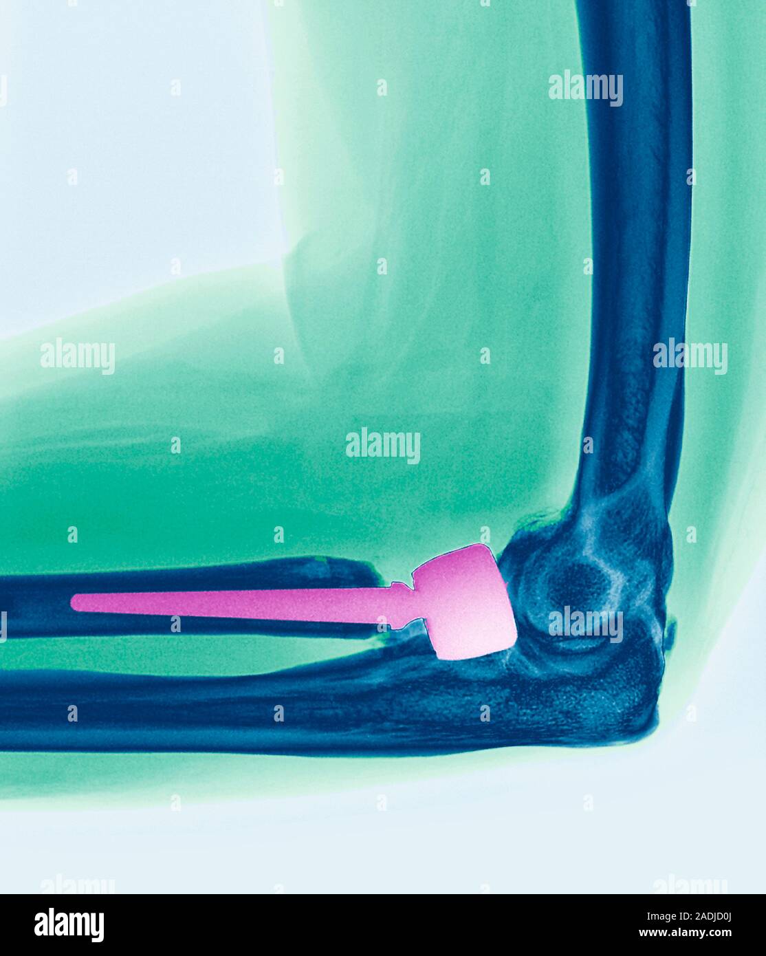Prosthetic elbow joint. Coloured X-ray of the arm of a 42 year old with ...