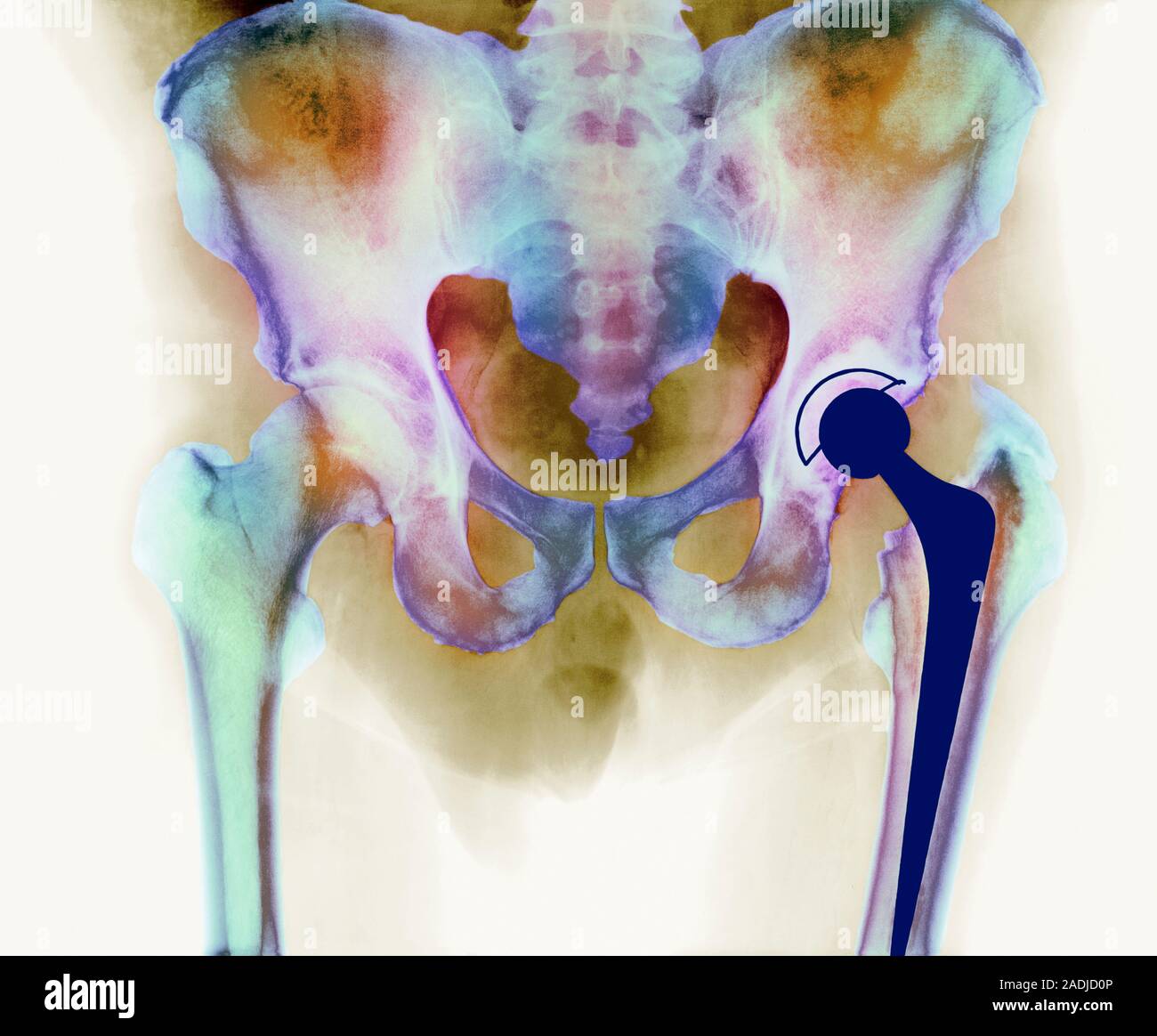 Hip joint replacement. Coloured X-ray of the pelvis (front view) of a ...