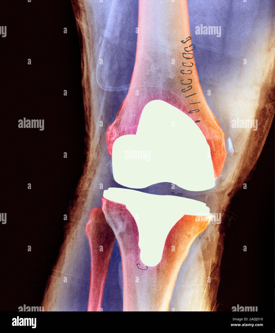 Knee joint replacement. Coloured X-ray of the knee of a 56 year old man ...