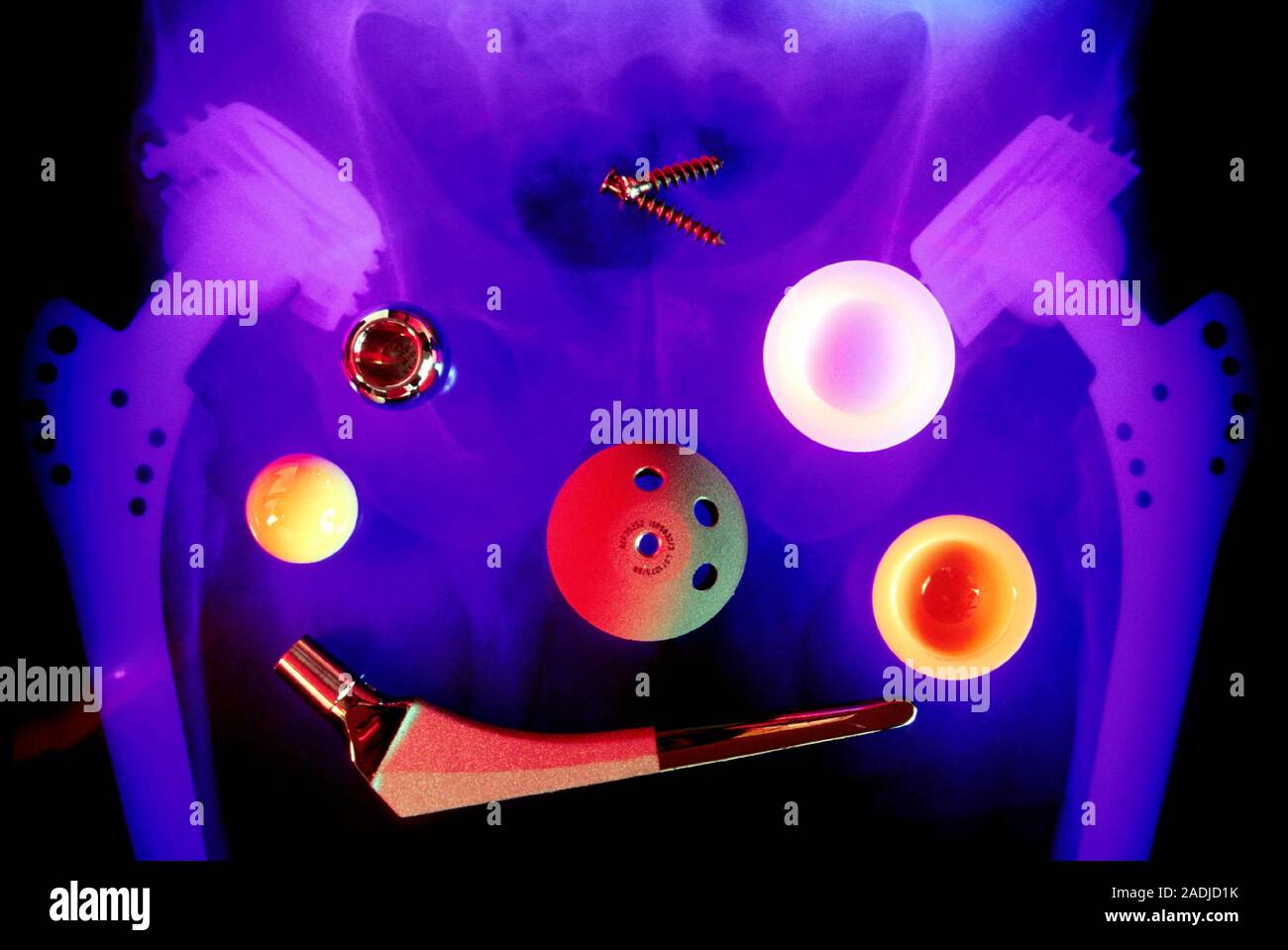 Artificial hips. X-ray of a patient with two artificial hips, with ...