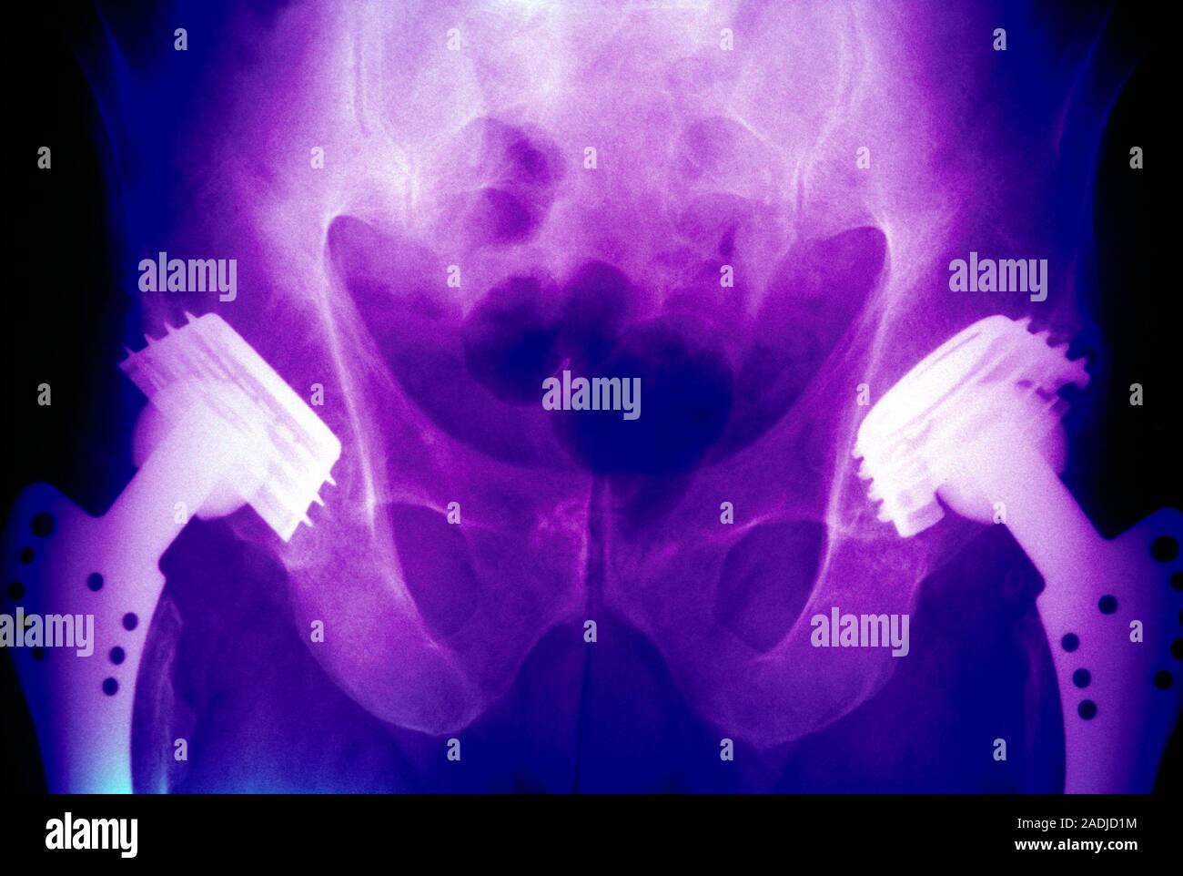 Artificial hips. X-ray of a patient with two artificial hips. The heads ...
