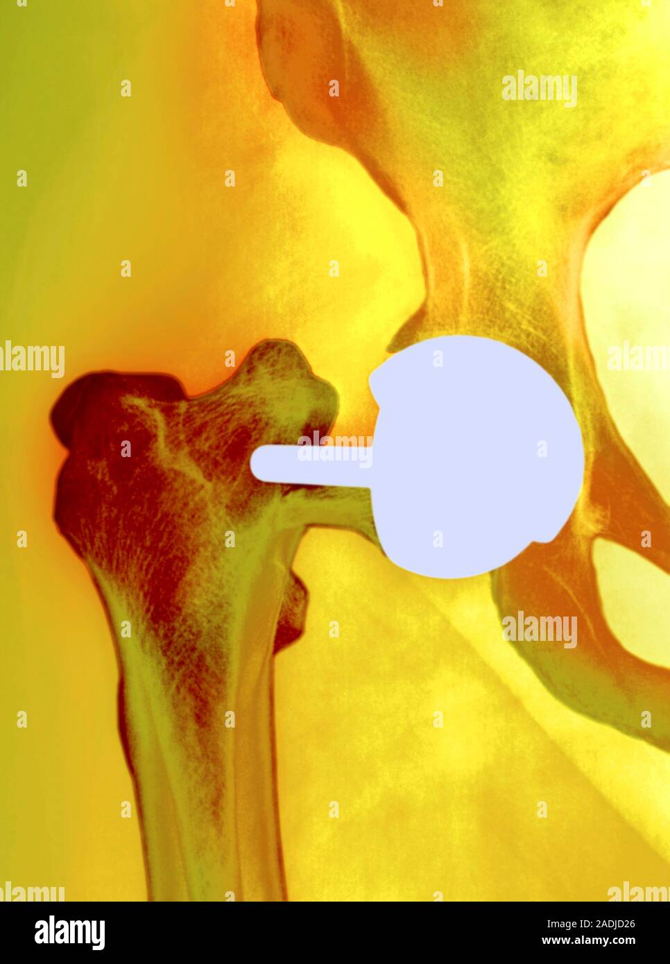 Failed hip resurfacing. Coloured X-ray of failed hip resurfacing in the ...