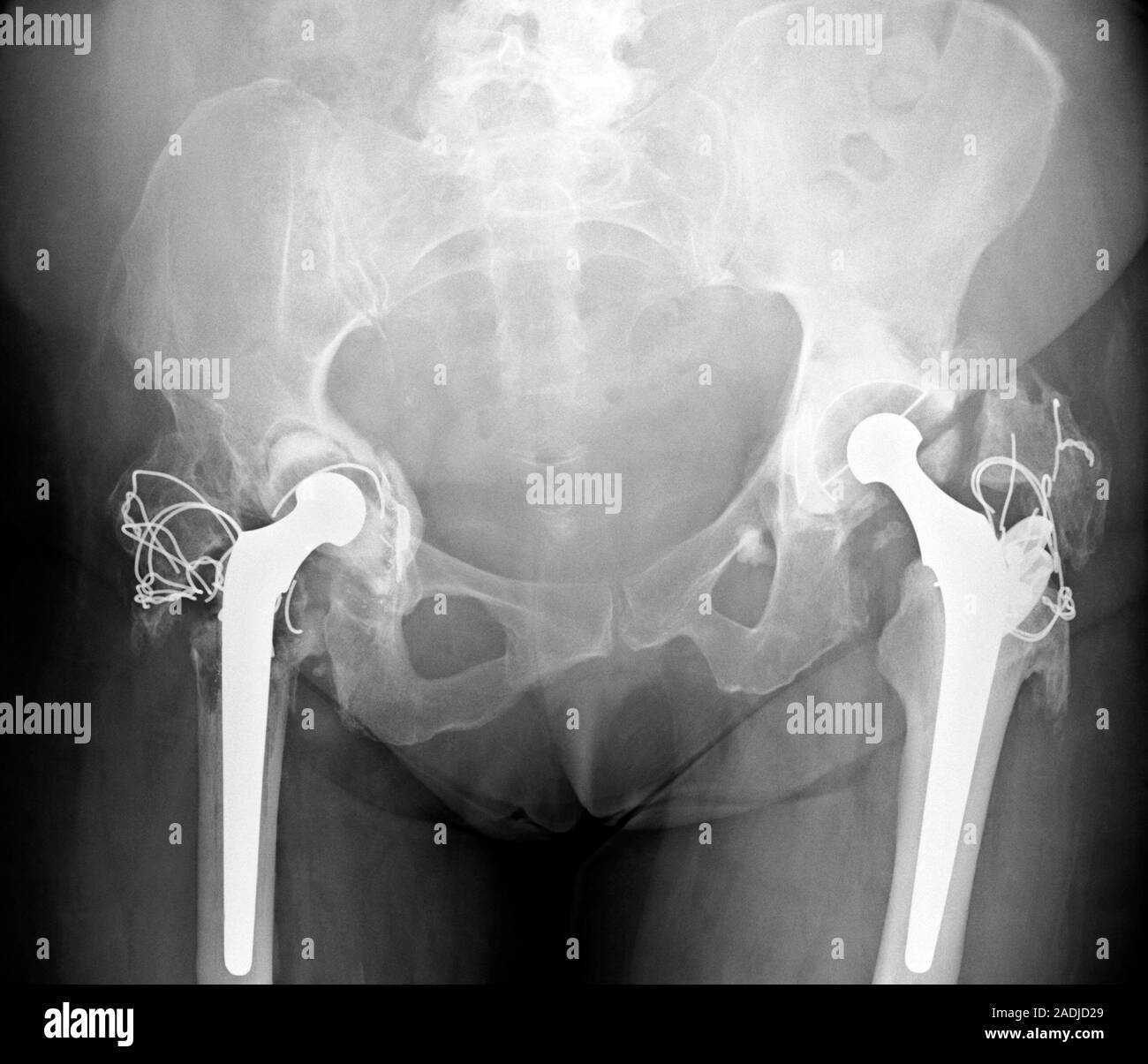 Failed total hip replacement. Coloured X-ray of the pelvis of a 74 year ...