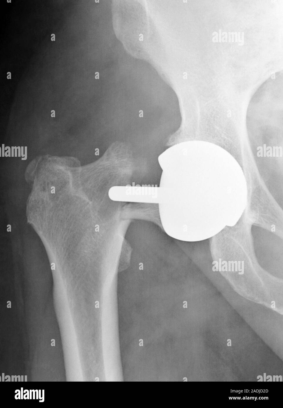 Failed hip resurfacing. X-ray of failed hip resurfacing in the pelvis ...