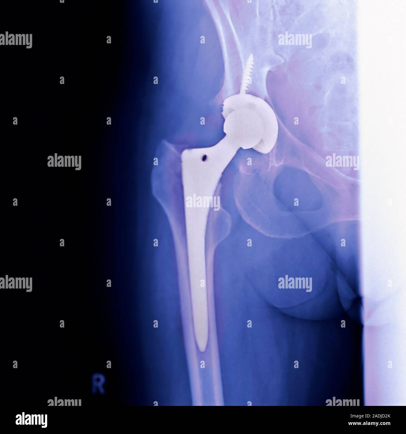 Total hip replacement. Coloured frontal X-ray of the right leg and ...