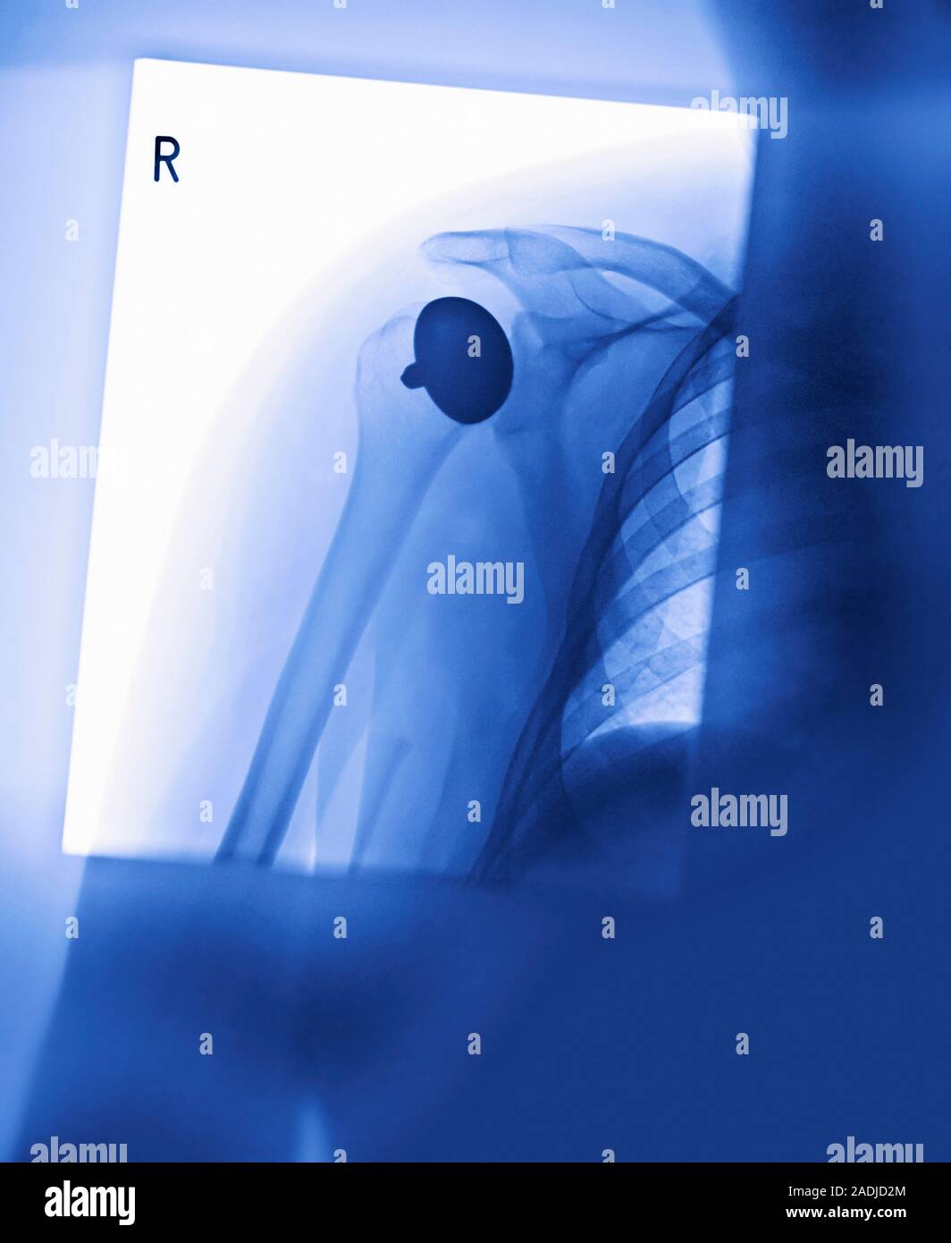 Artificial shoulder. Coloured frontal X-ray of the right shoulder of a ...