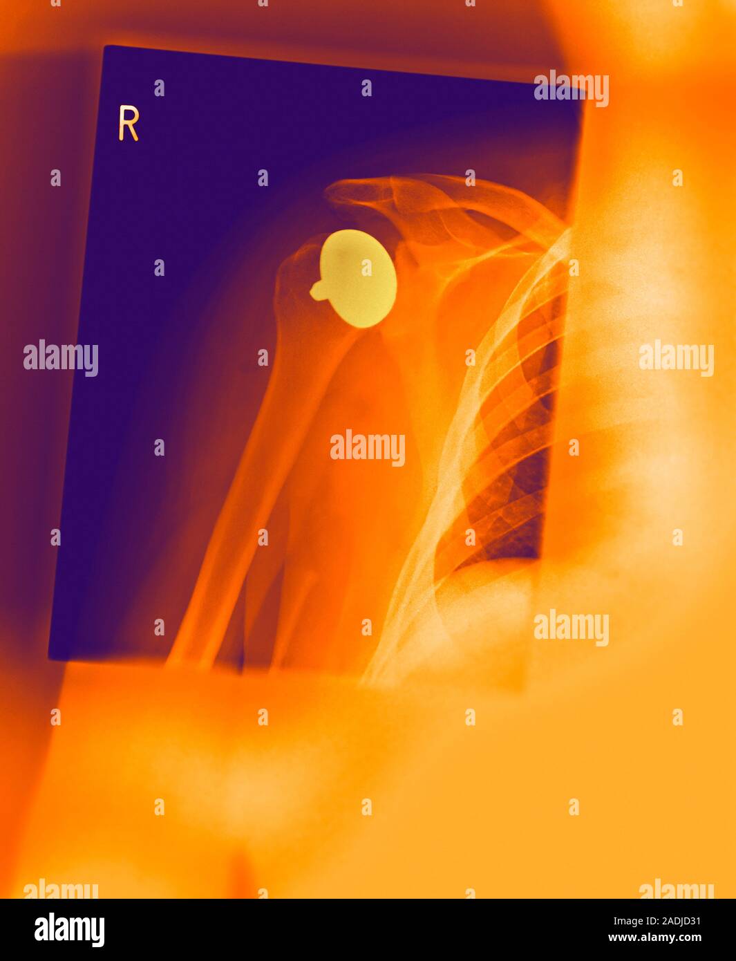 Artificial shoulder. Coloured frontal X-ray of the right shoulder of a ...