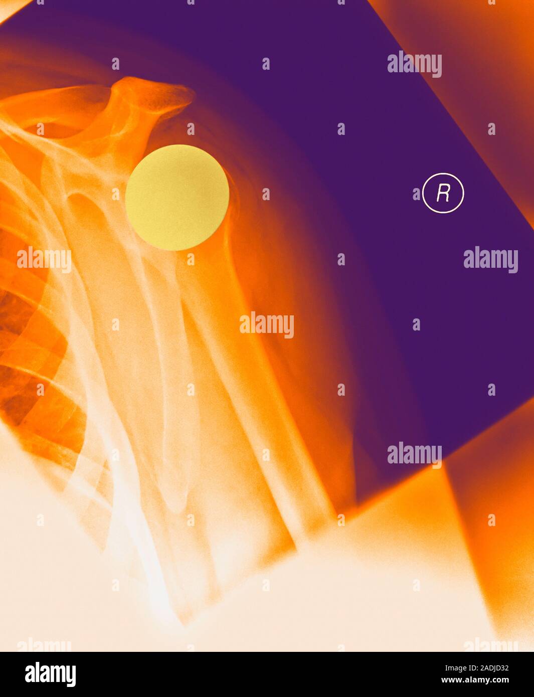 Artificial shoulder. Coloured X-ray of the back of the right shoulder ...