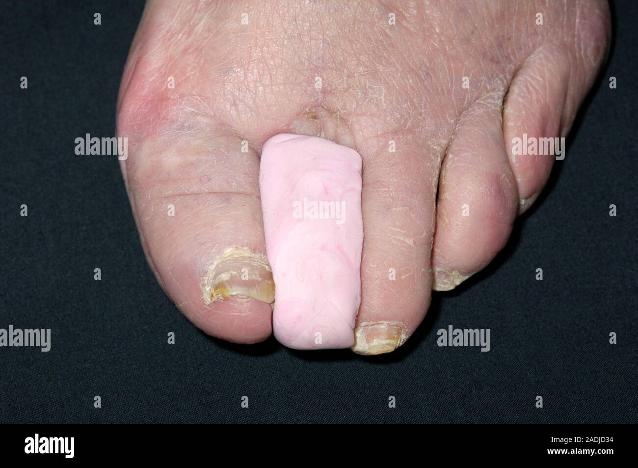 Toe prosthesis following amputation. This spacer" prosthesis (pink ...