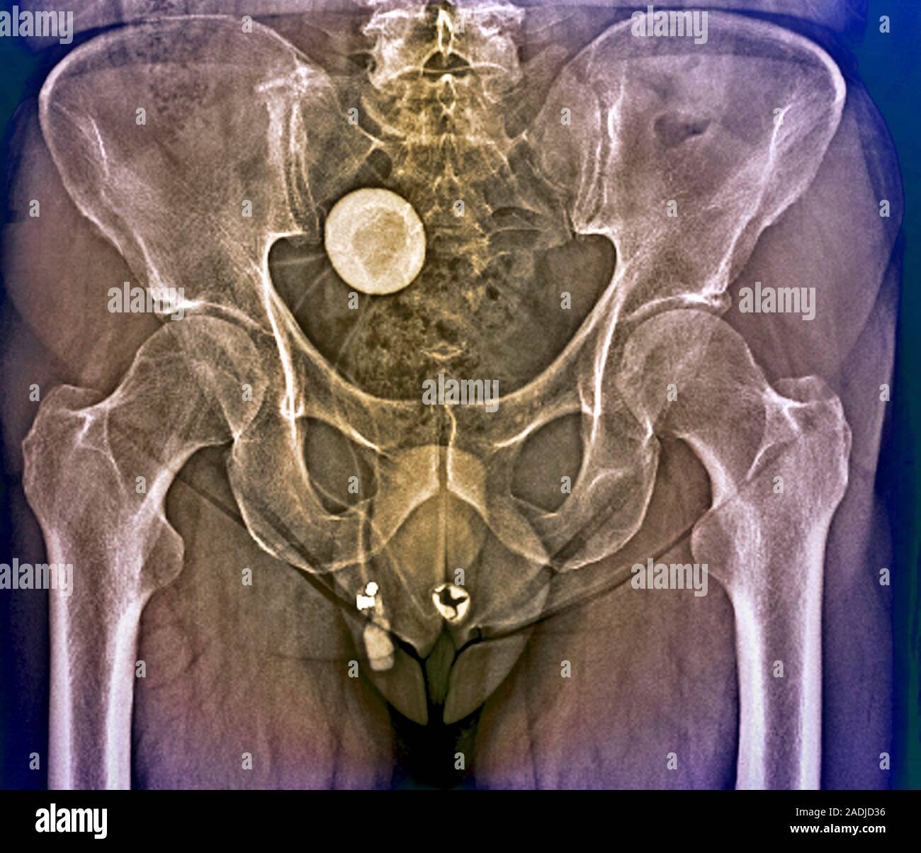 Artificial urinary sphincter. Coloured frontal X- ray of a 64-year-old ...