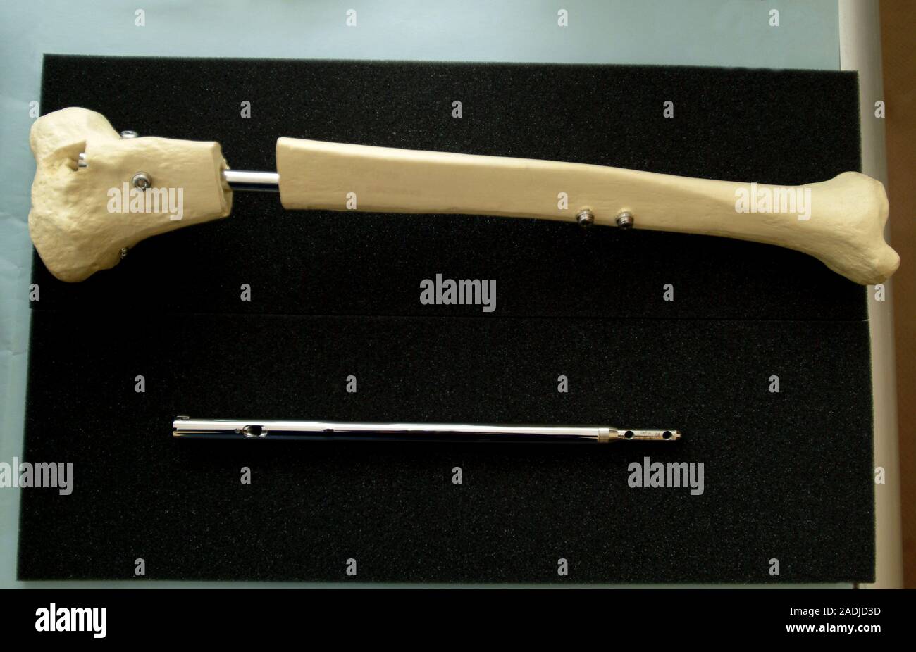 Bone lengthening implant. Demonstration of a telescopic nail (lower ...