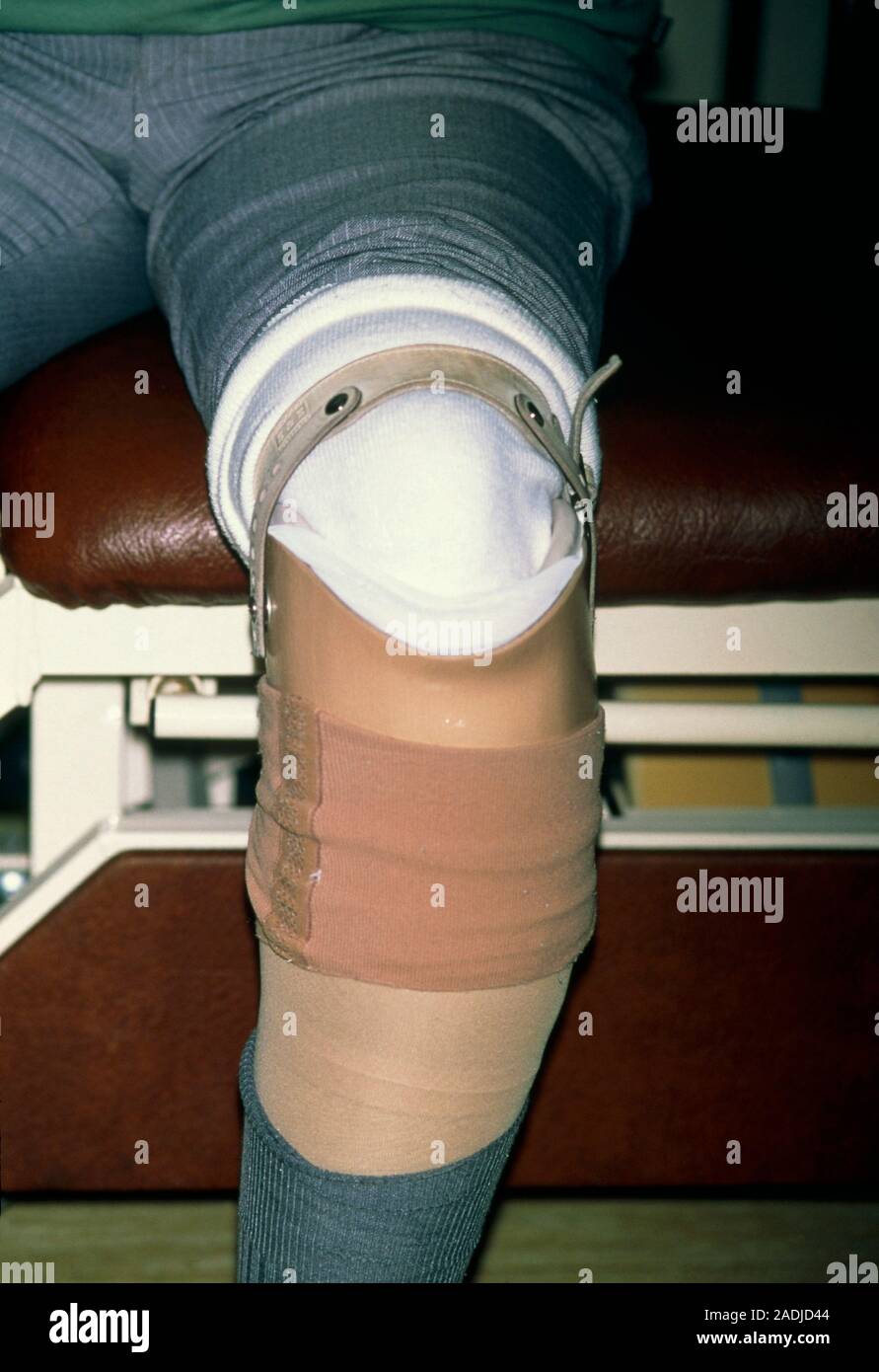 Prosthetic lower leg. View of a prosthetic lower leg attached to the ...