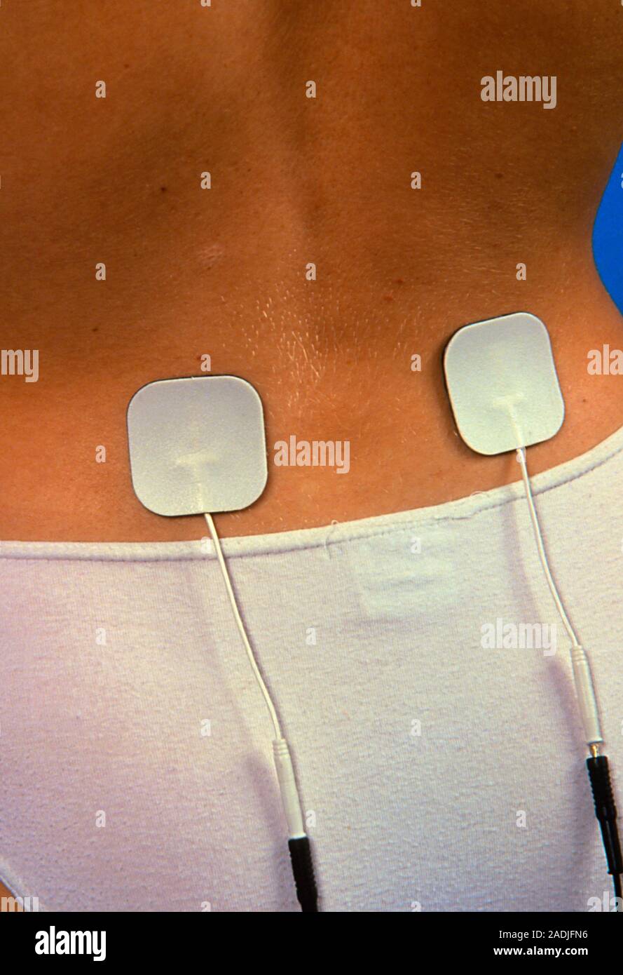 Patient wearing TeNS pads. TeNS (Transcutaneous electrical Nerve ...