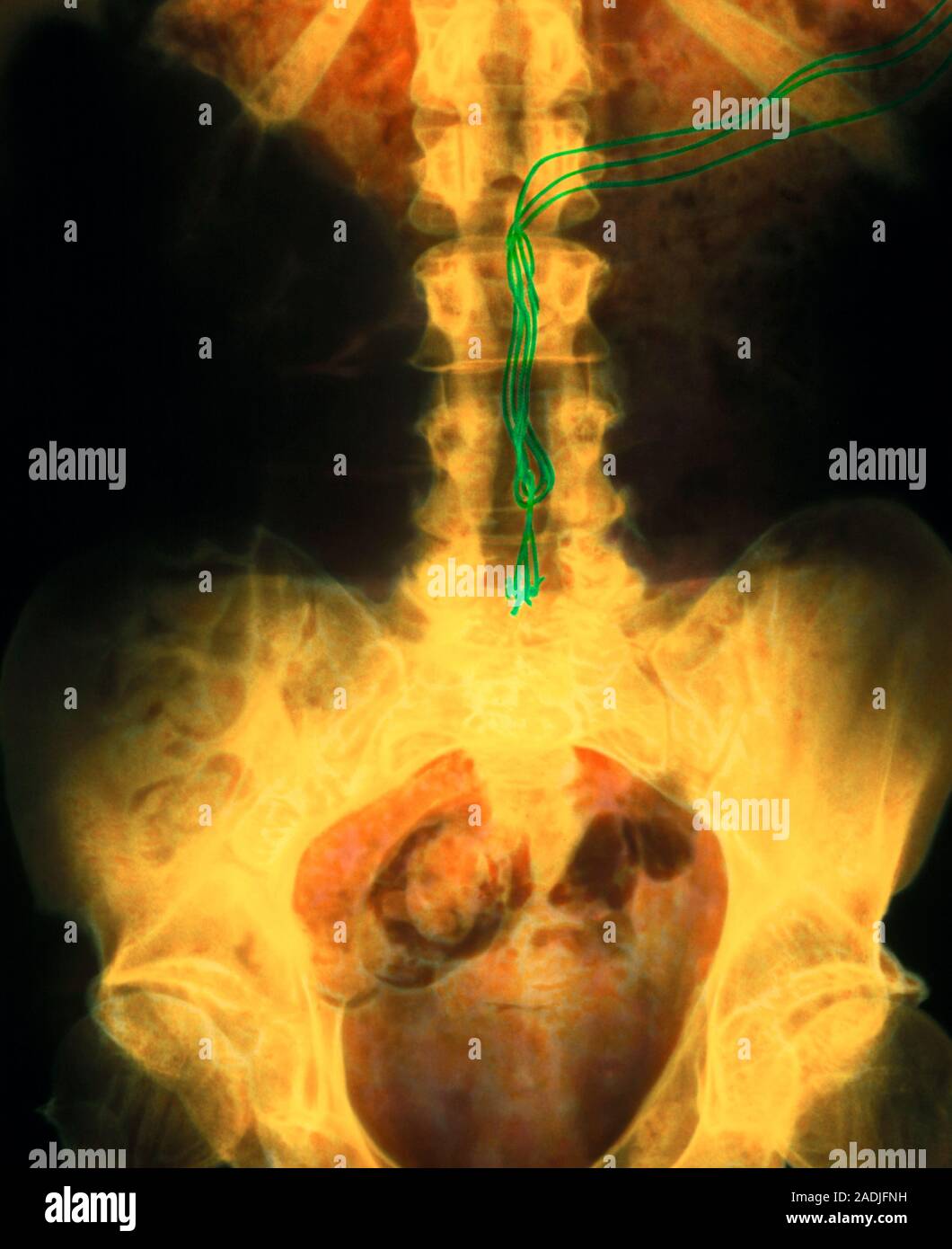 Spinal column nerve stimulator. Coloured X-ray of the wires (green) of ...